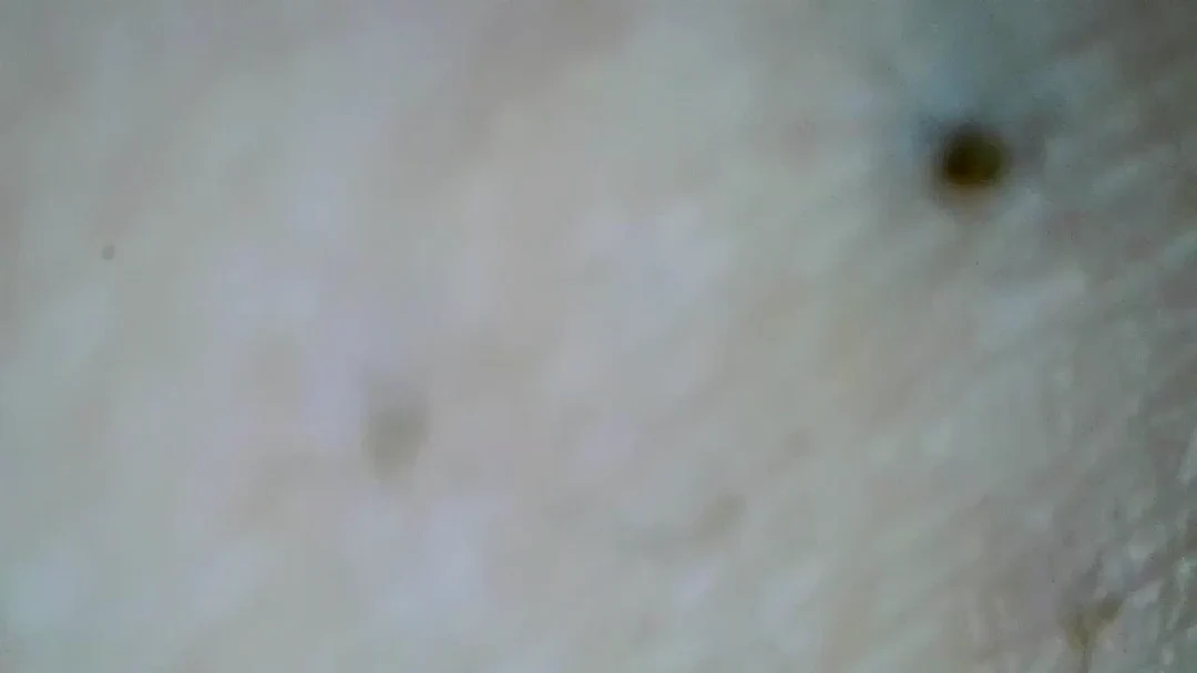 Another microscope blackhead extraction | Scrolller