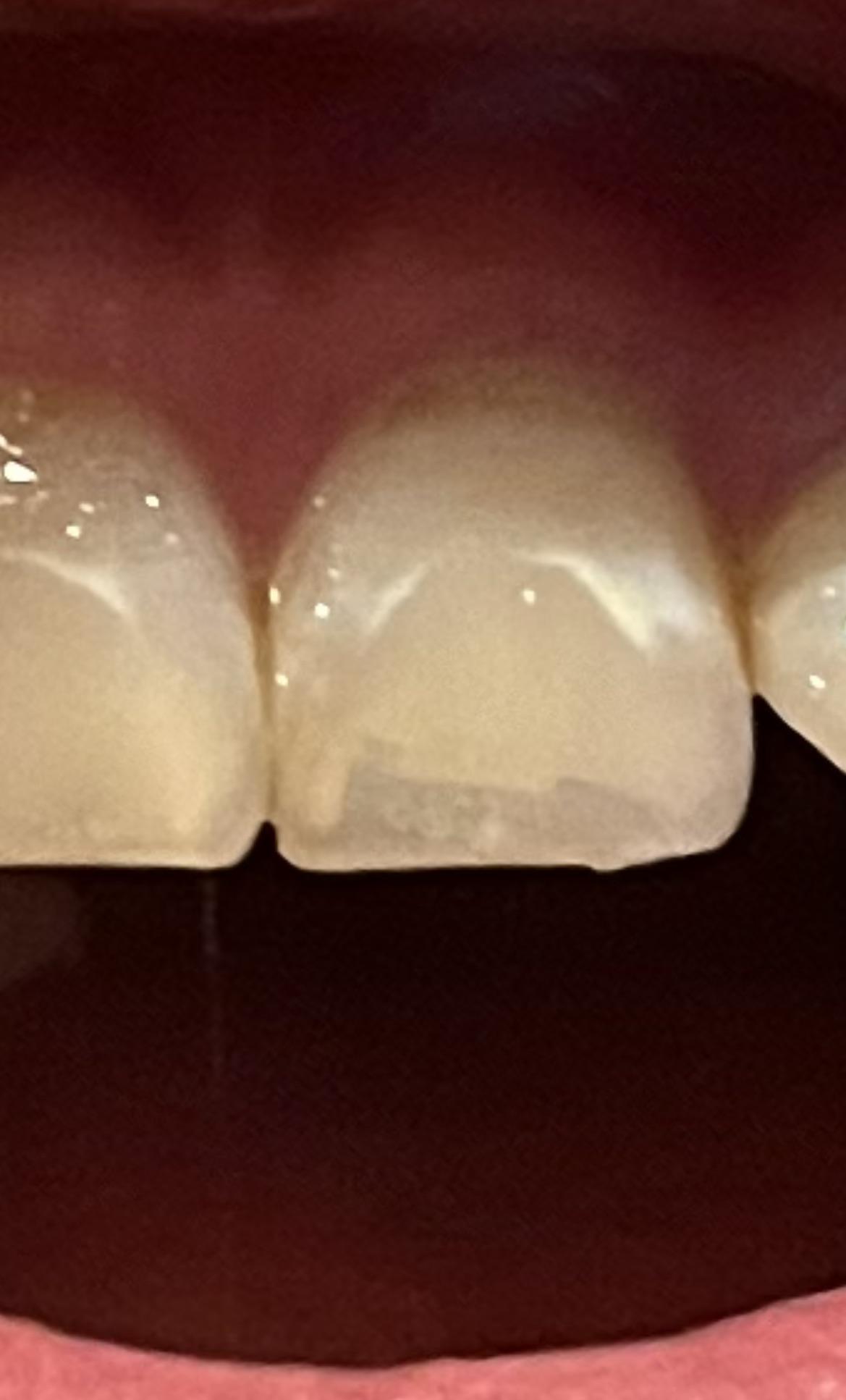 Translucent filling/bonding? | Scrolller