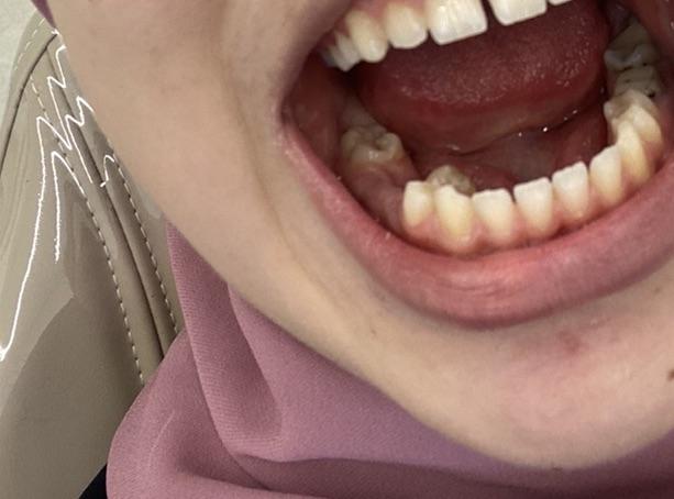 Tooth being PULLED 🙏🏻🥳 | Scrolller