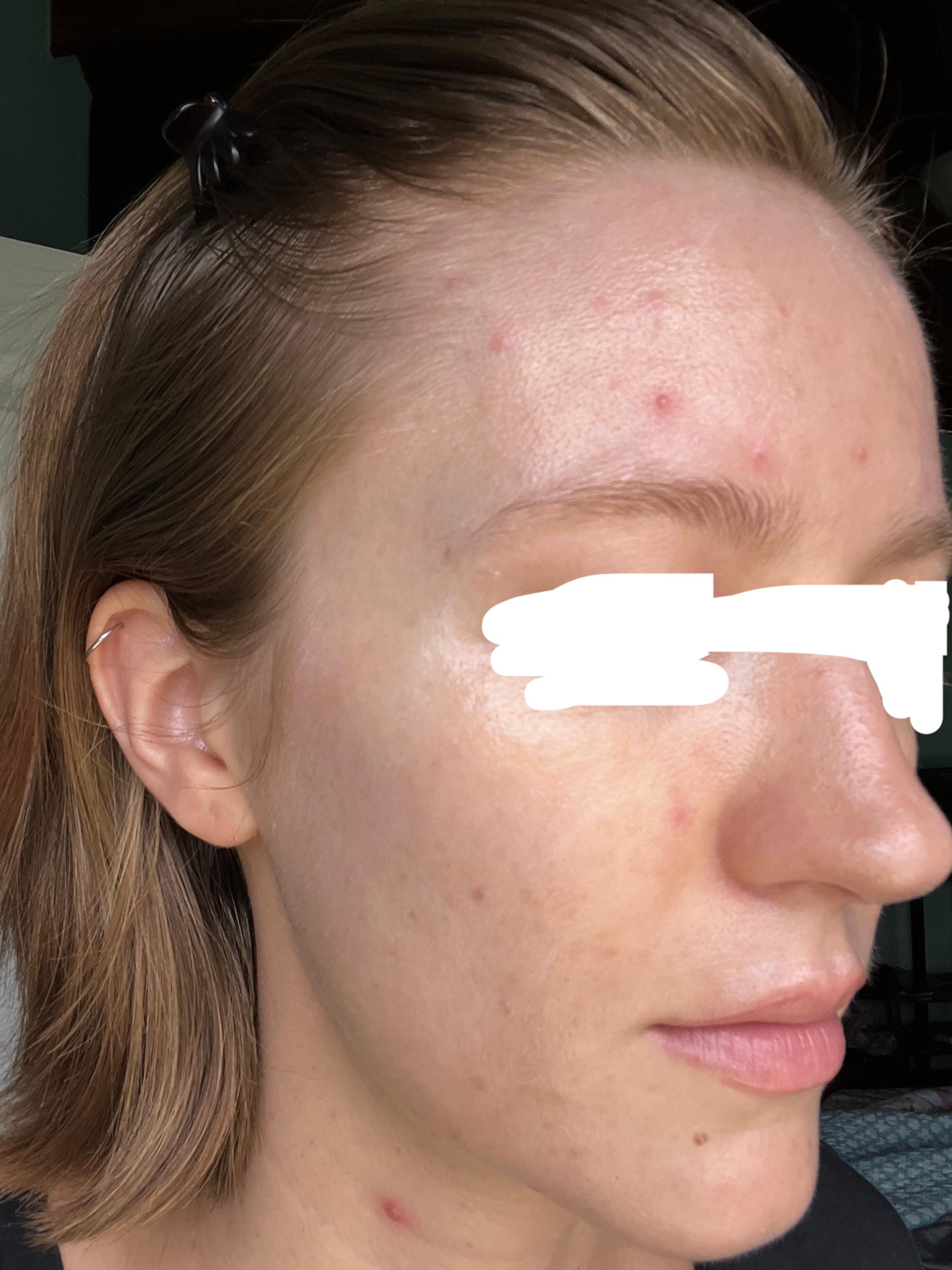 Forehead texture and redness is a persistent problem | Scrolller