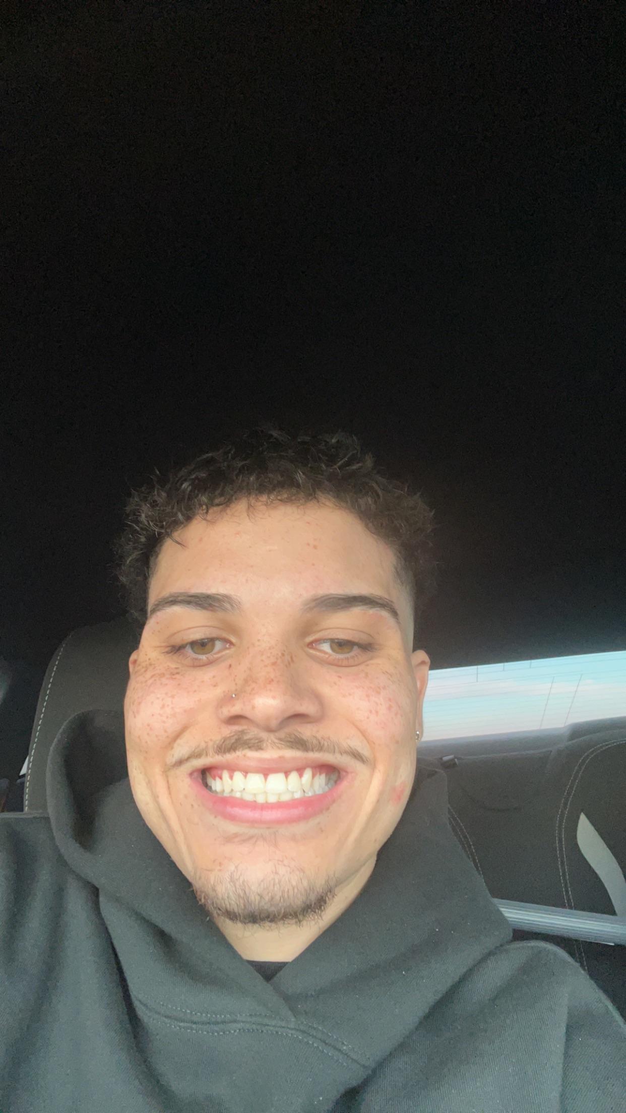 Finally got them off 😬🦷 | Scrolller