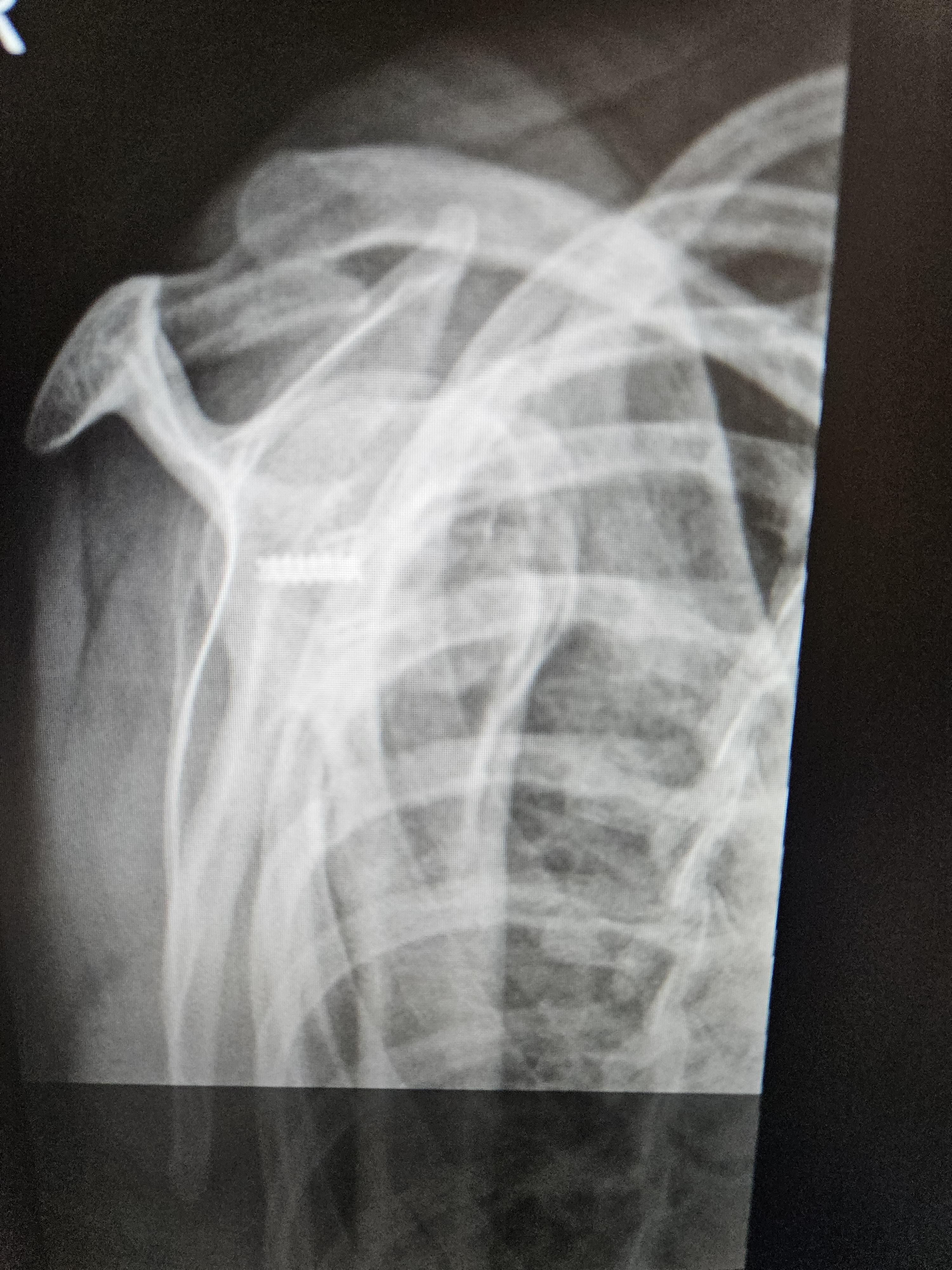 Shoulder | Scrolller