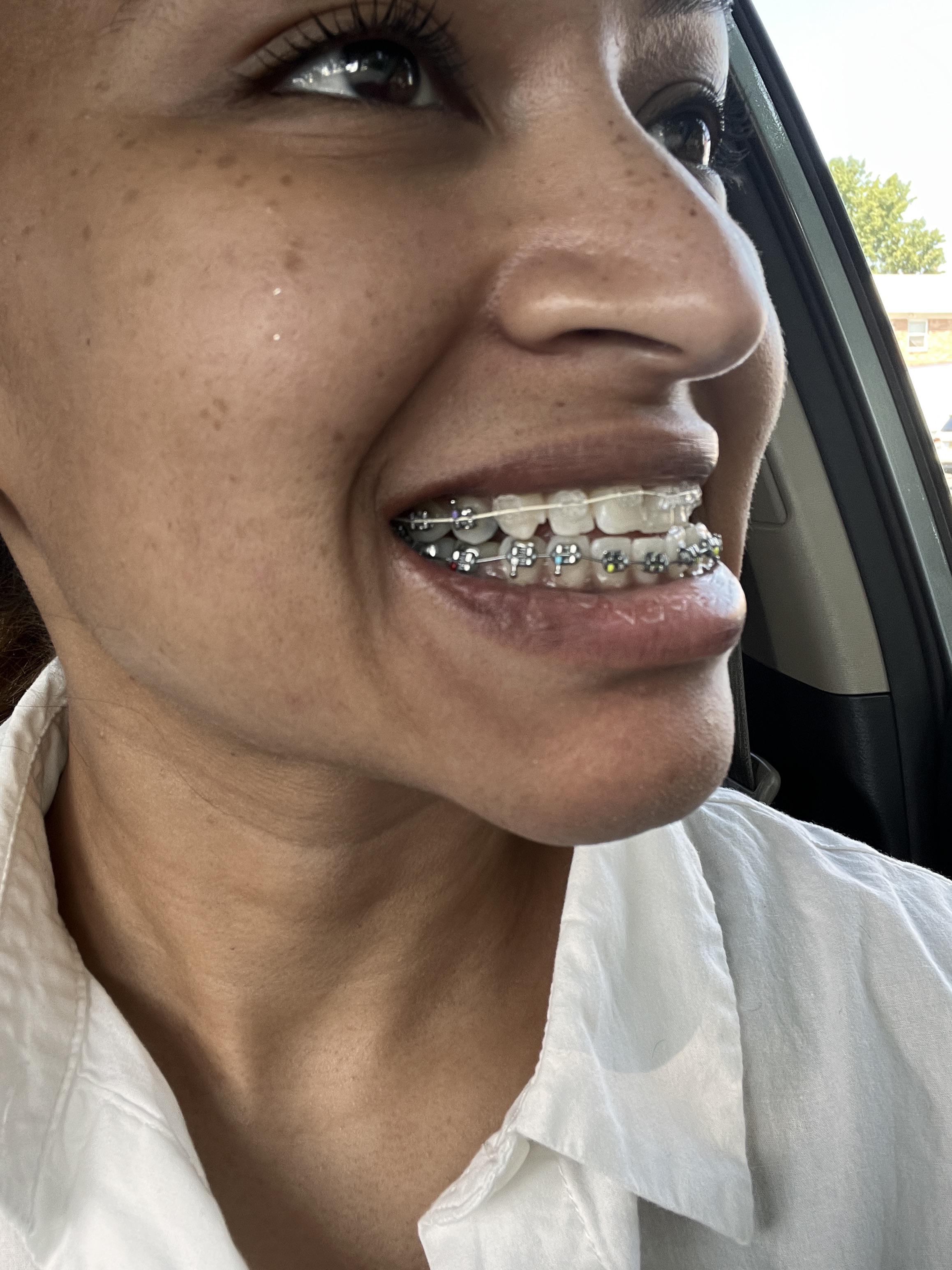I officially started my journey to straight teeth and DJS!! | Scrolller