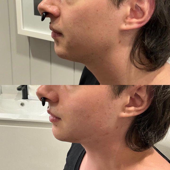 Before and After Facial Masculinisation via Filler | Scrolller