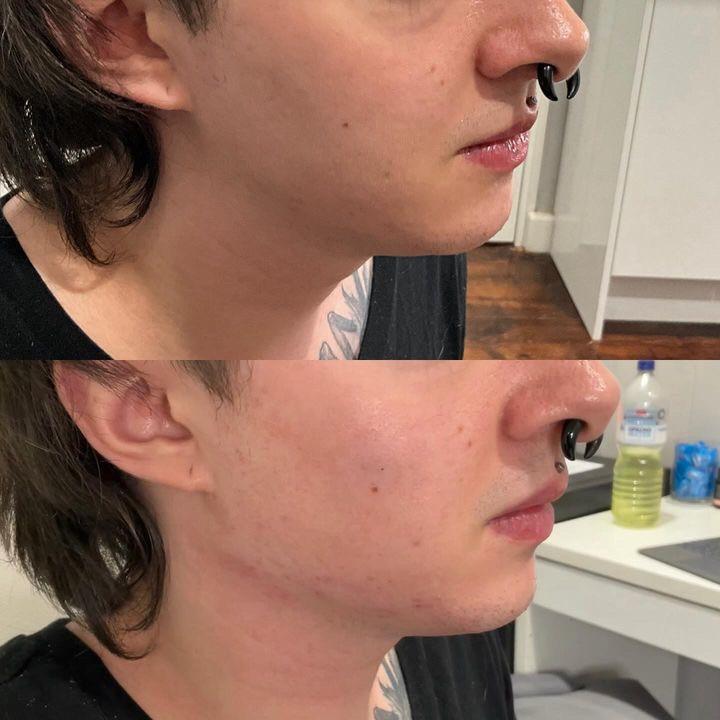 Before and After Facial Masculinisation via Filler | Scrolller