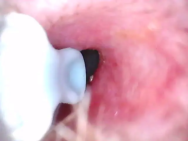 Hearing Loss and Redness inside ear canal | Scrolller