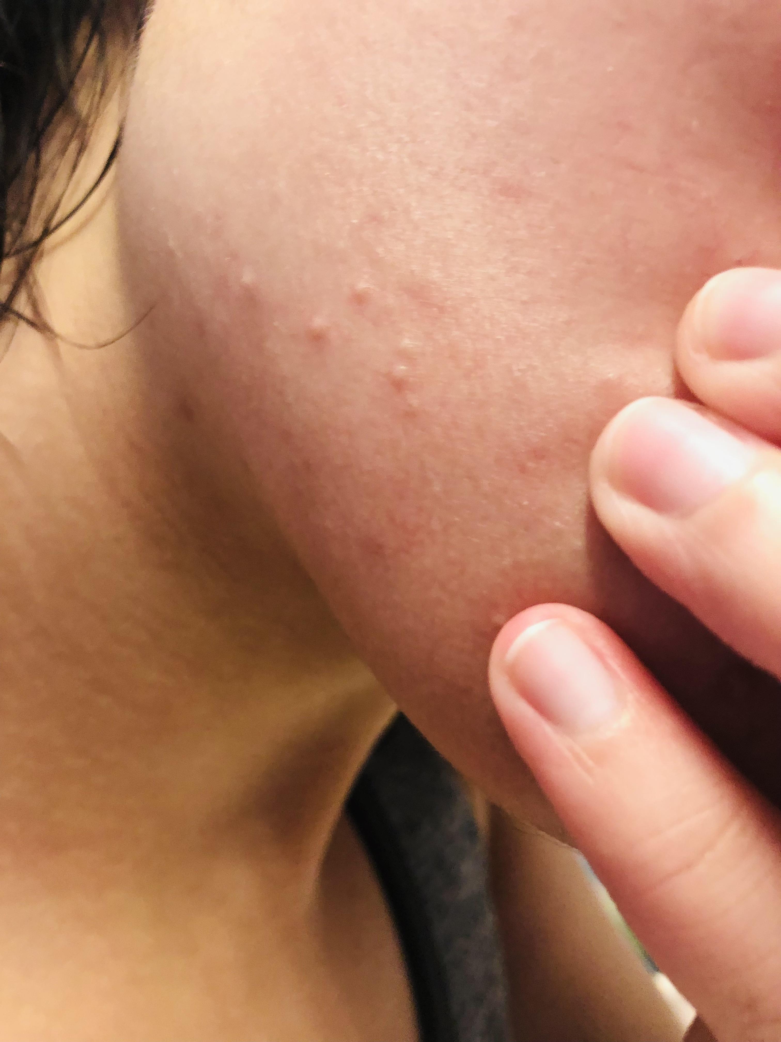 How to get rid of bumps like these? | Scrolller