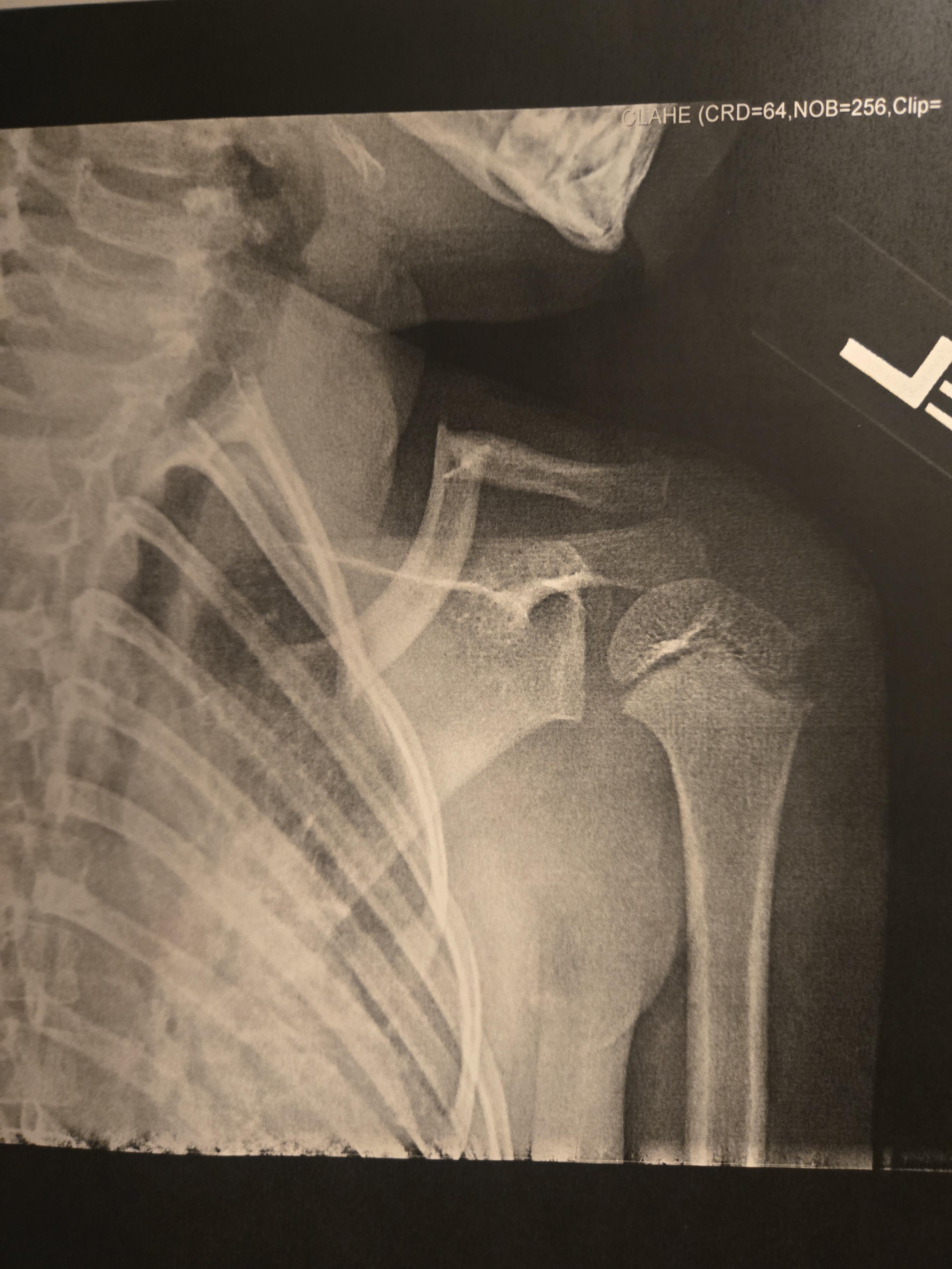 Pediatric Clavicle Fracture | Scrolller
