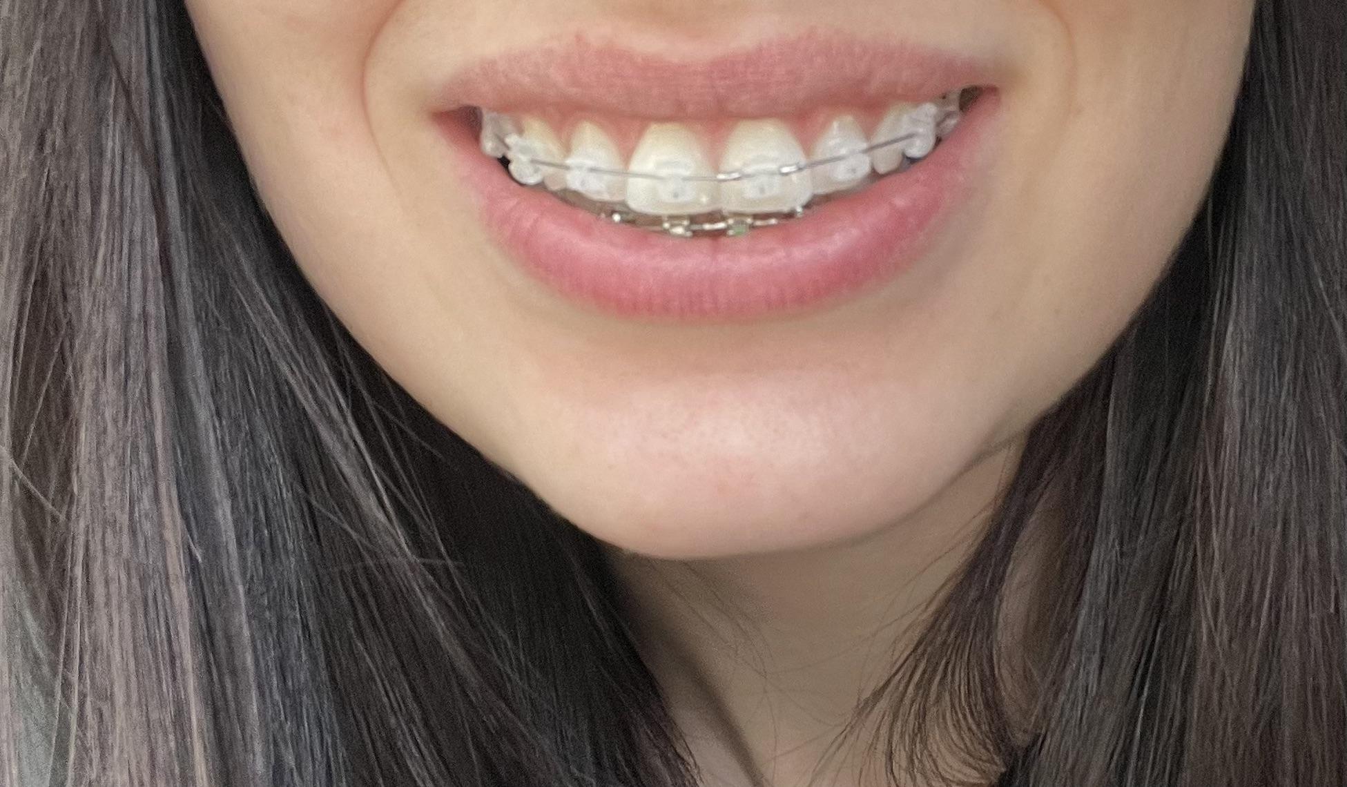 Day 1 with Damon clear braces on top and Damon metal on bottom | Scrolller