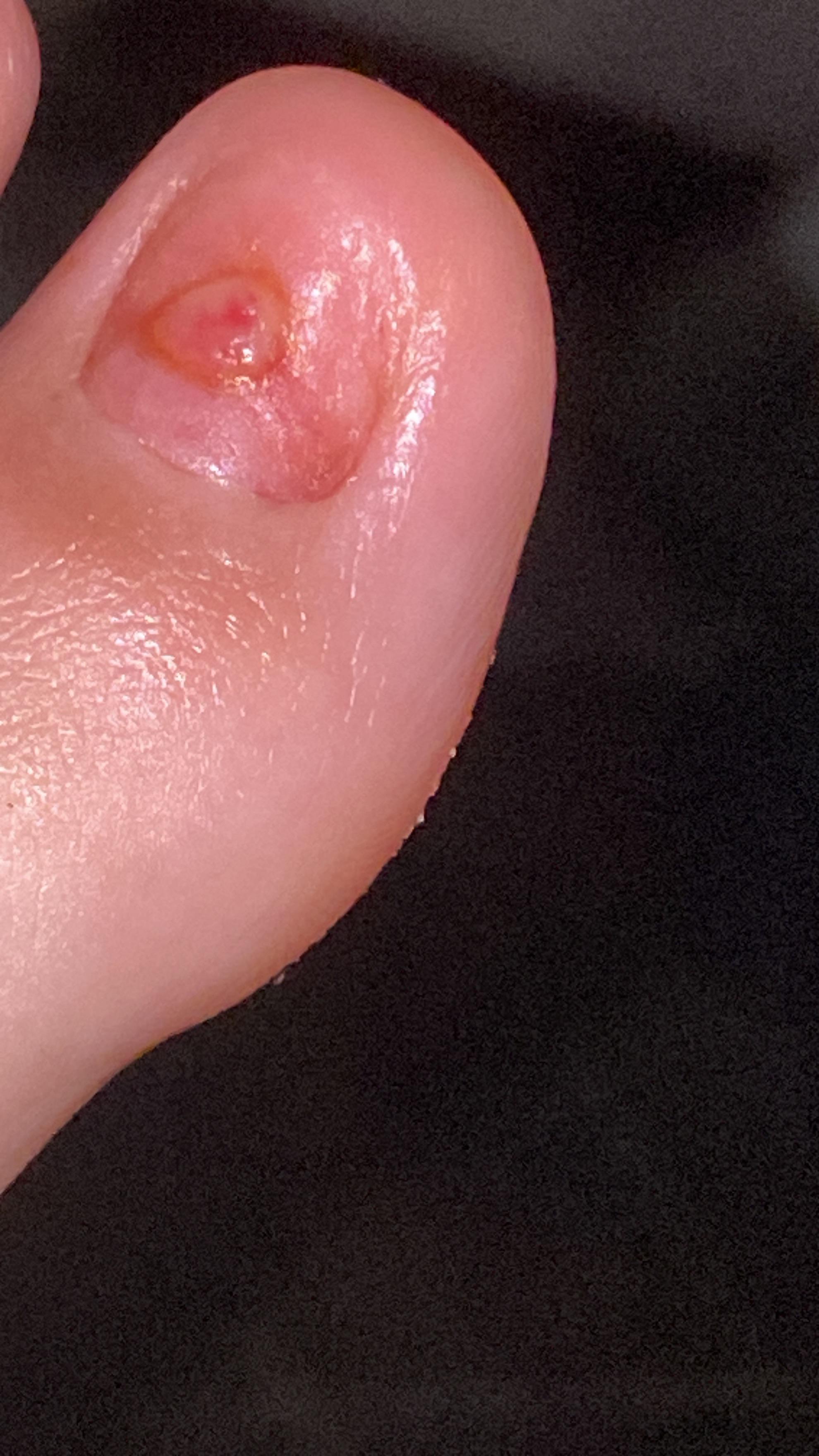 Is my toenail removal healing well? | Scrolller