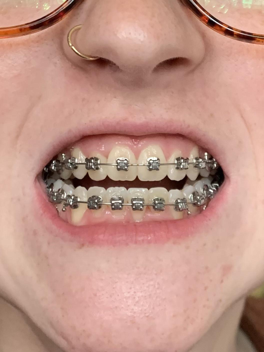 6 Month progress, it’s insane how much has changed | Scrolller