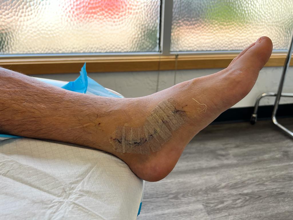 Kidner Procedure and Repair of Posterior Tibular Tendon - 2 weeks post OP | Scrolller