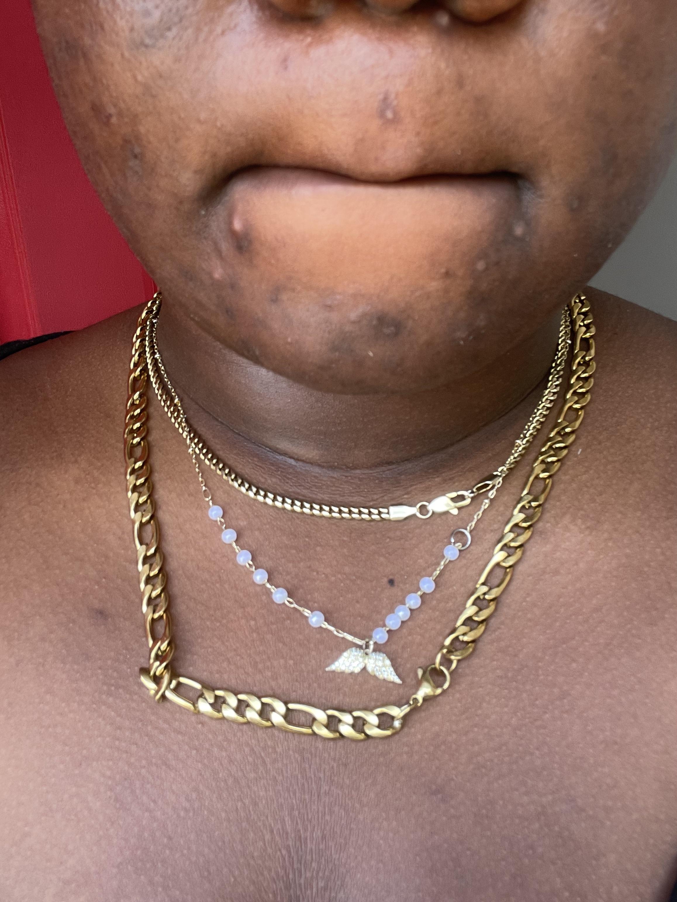 How can I get rid of my scars/dark spots | Scrolller