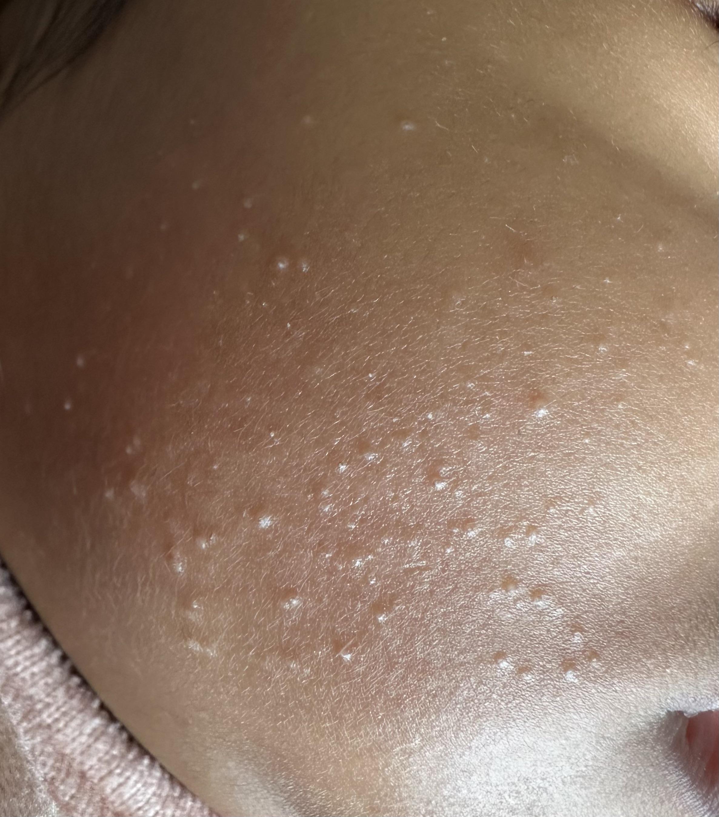 Discover more like Acne: Is this good progress?2 weeks of using clotrimazole and Related Content ...