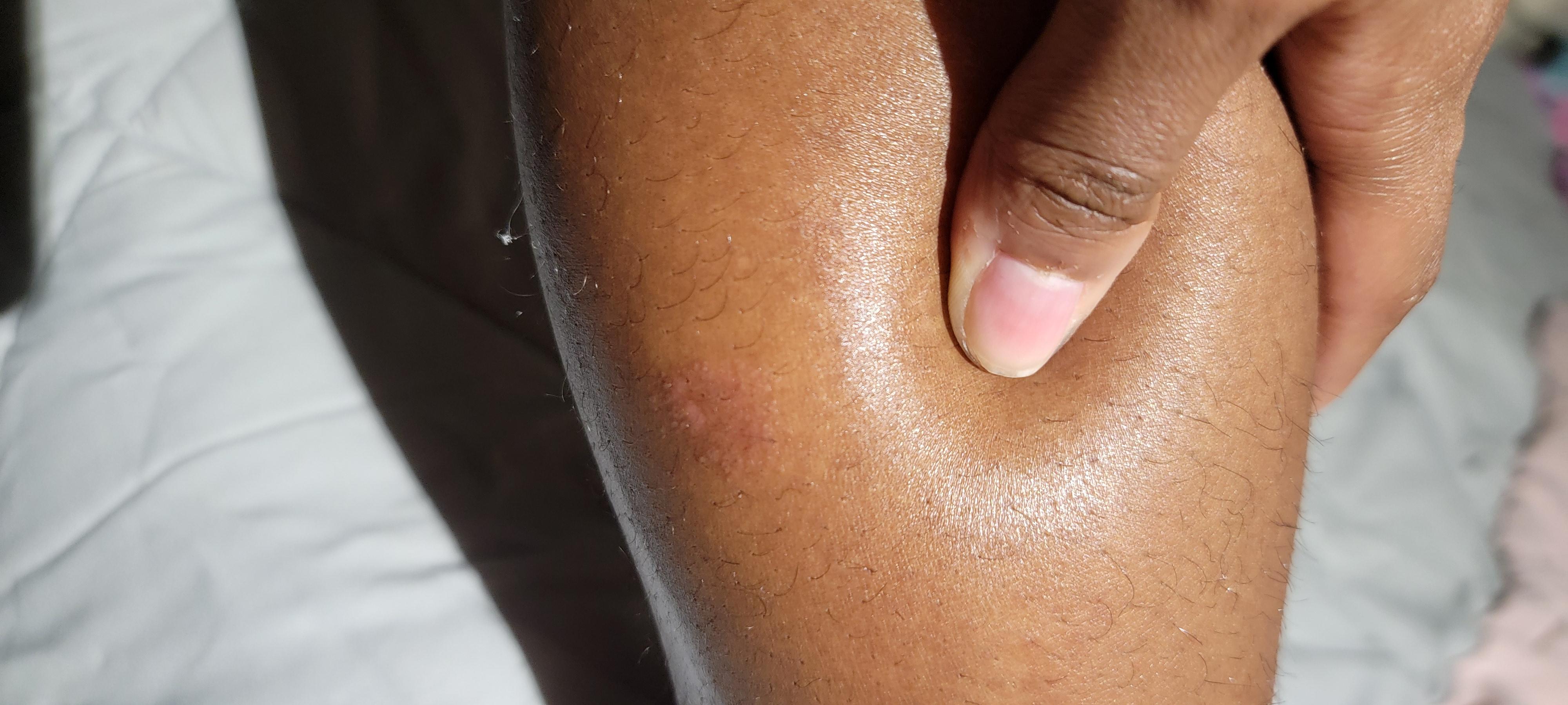 Little area of Small bumps and dry skin | Scrolller