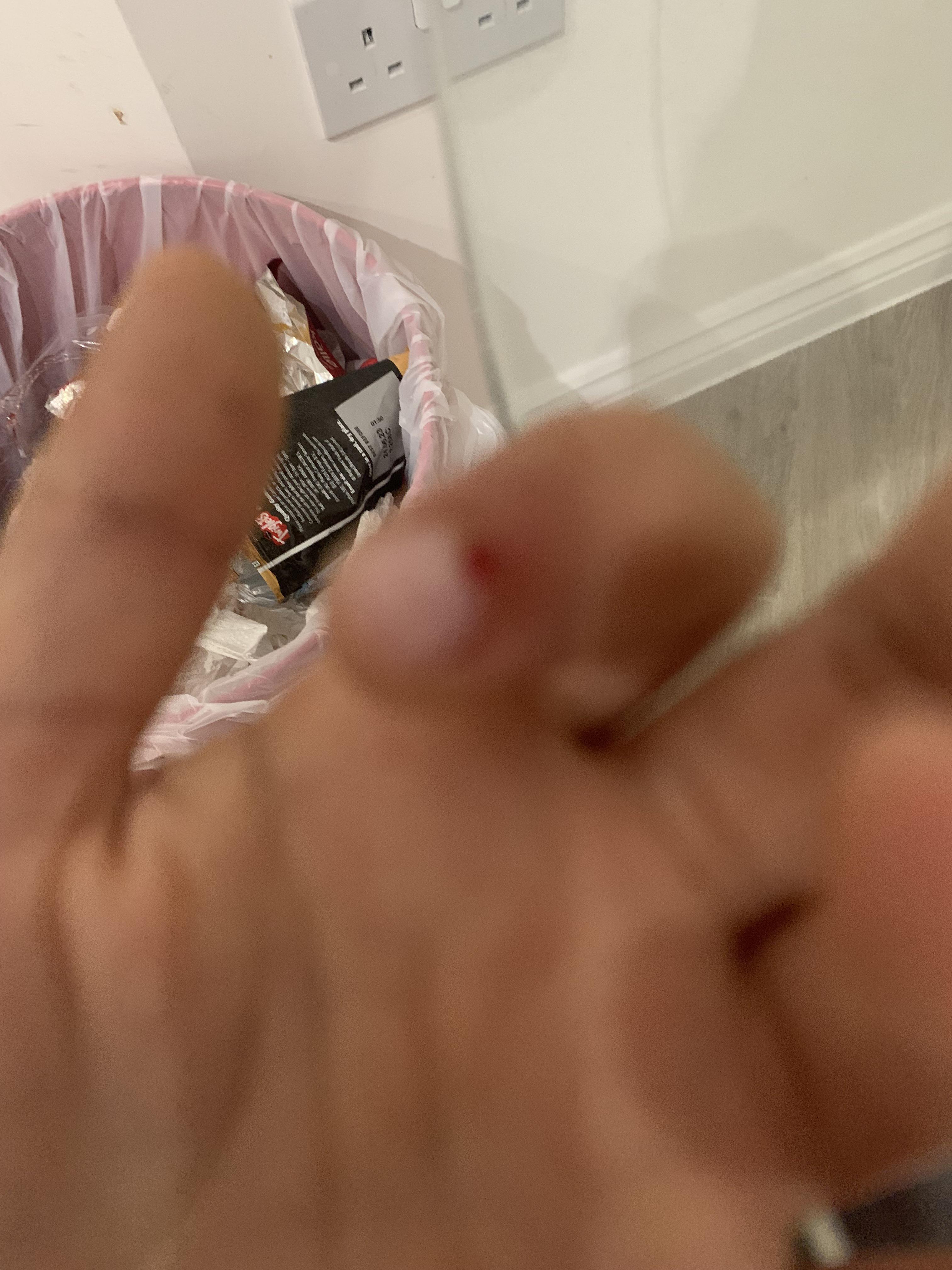 My finger is bleeding | Scrolller