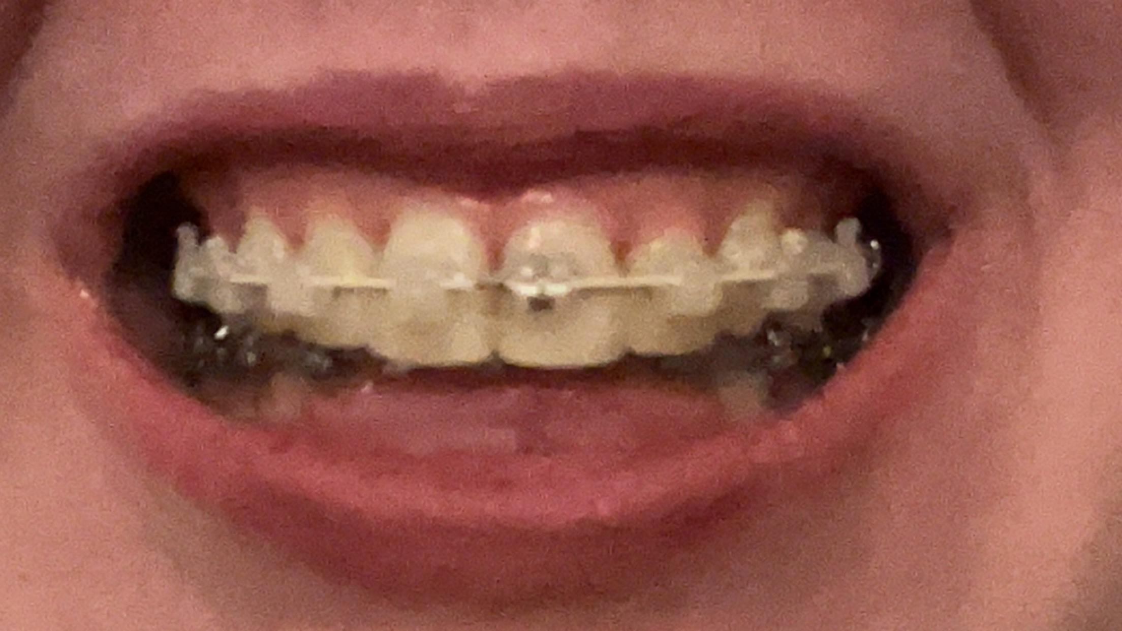 Braces Coming Off Deep Bite Cannot Be Fixed Scrolller 1553
