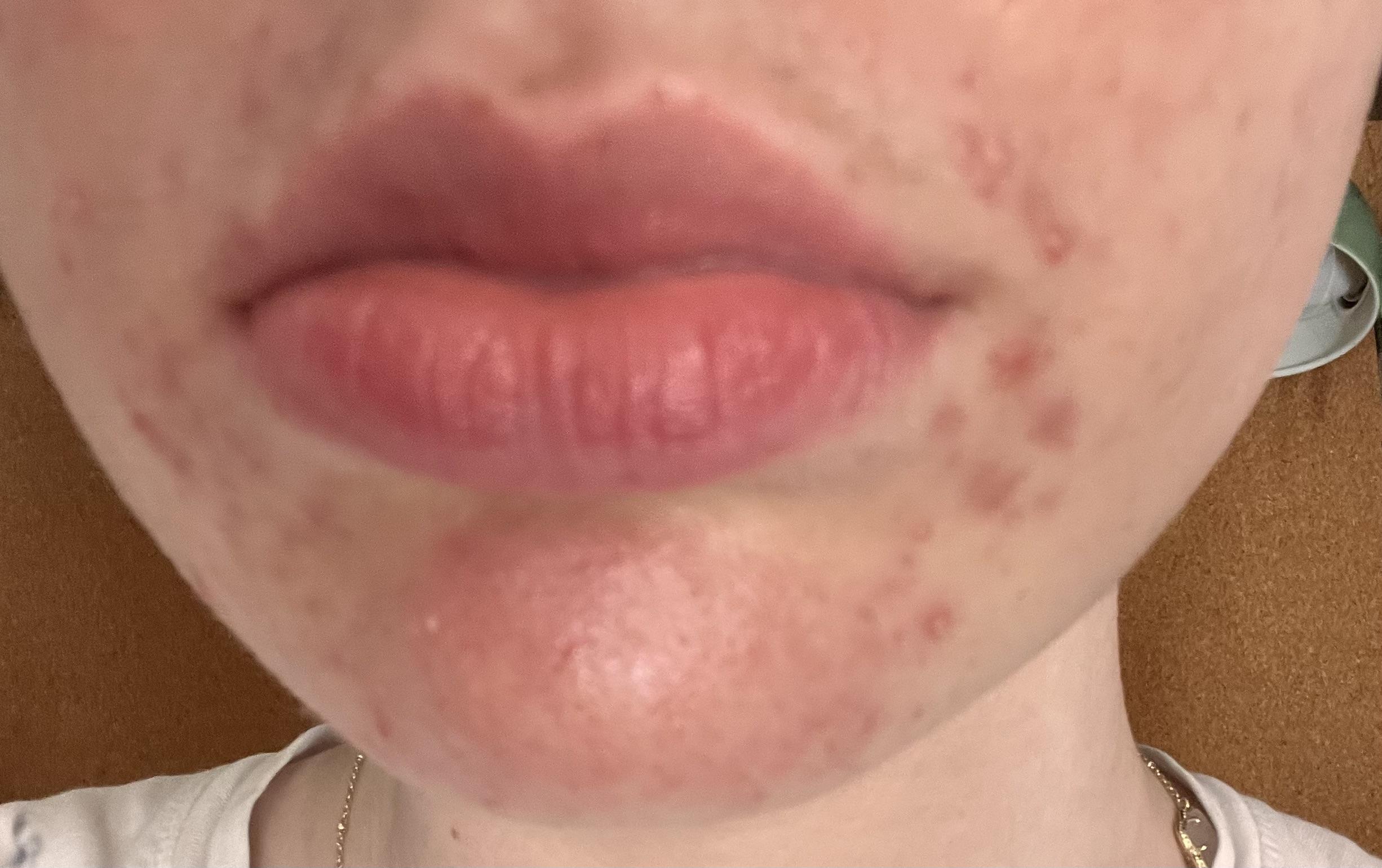 Pimples around mouth that won’t go away. I’m gonna go absolutely insane. | Scrolller