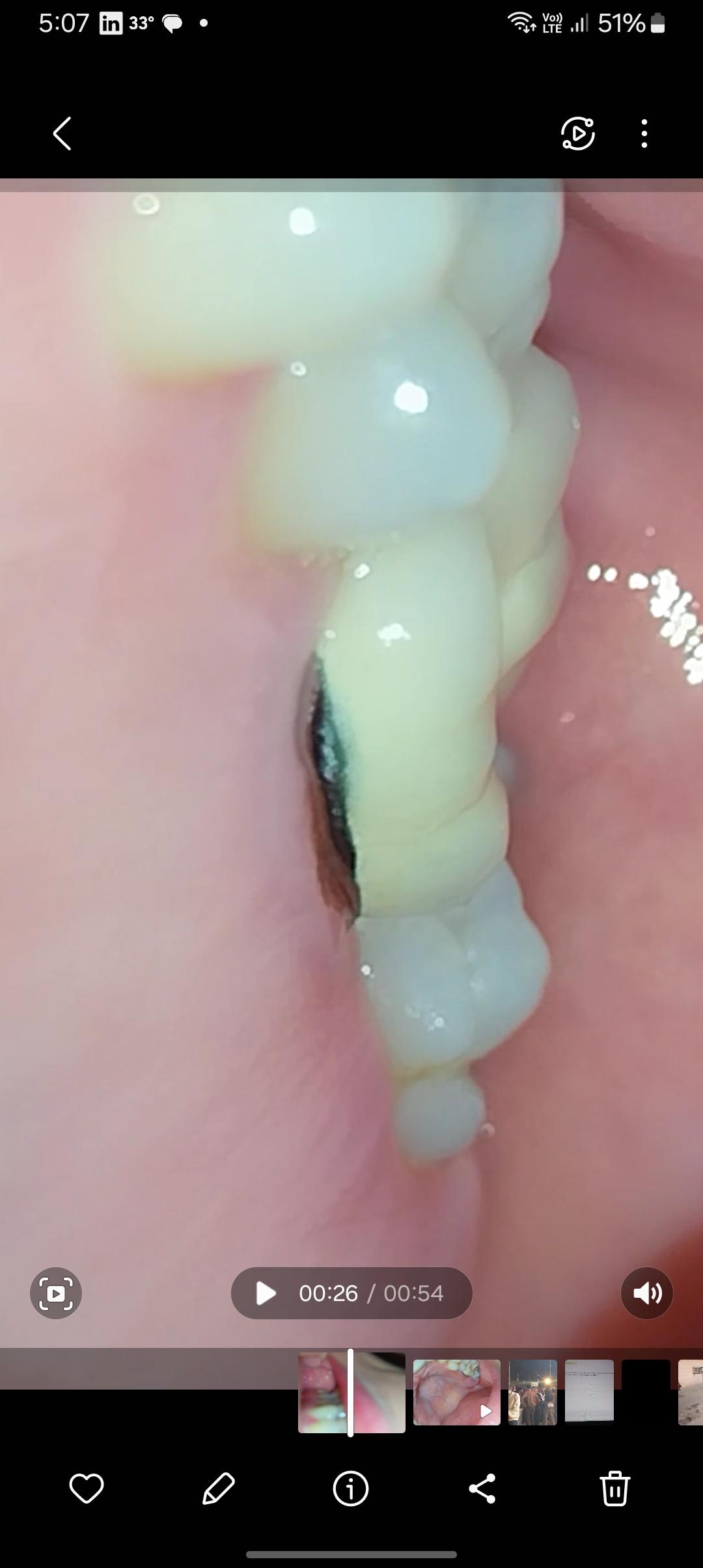 Some black spots in teeth | Scrolller