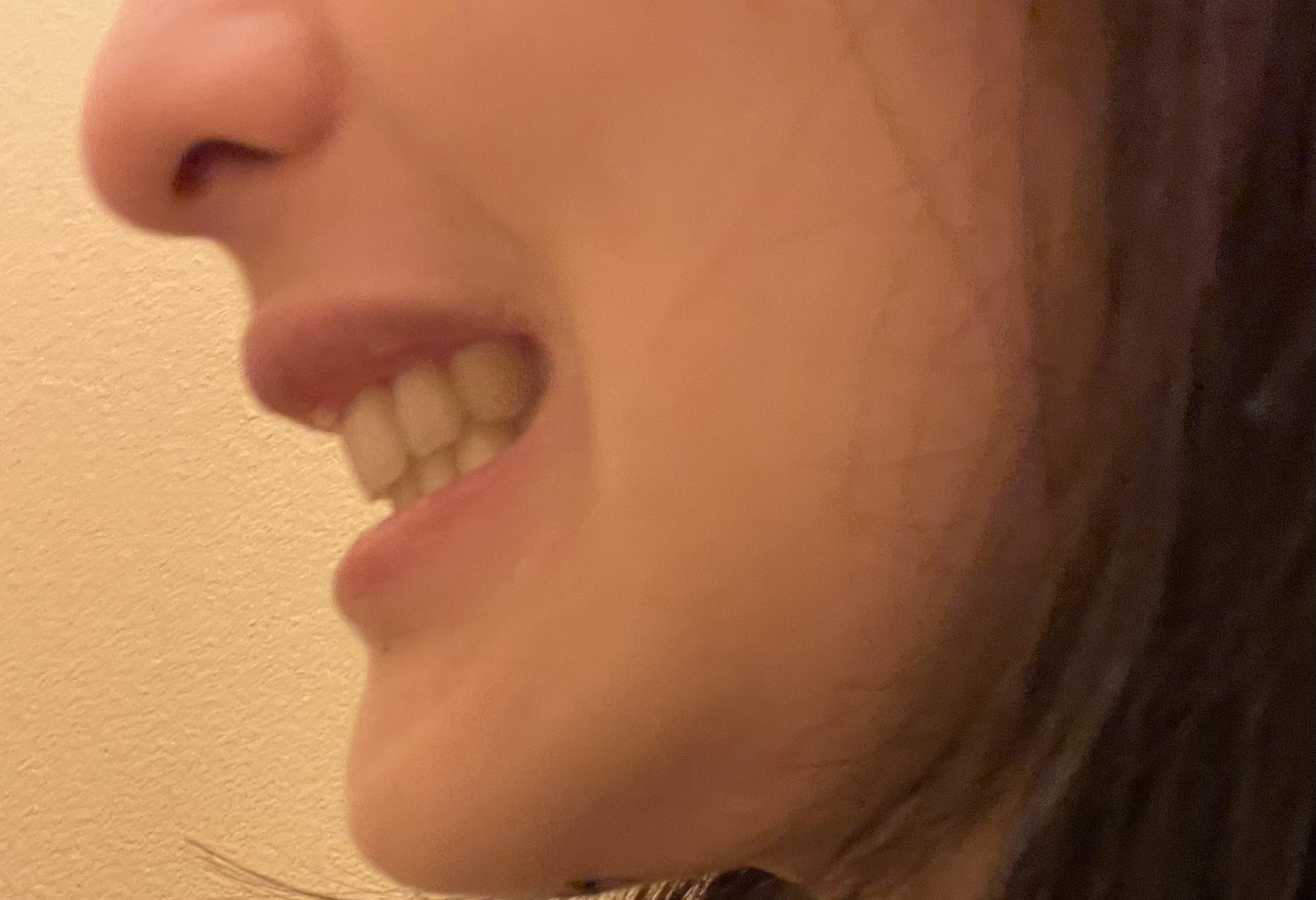 Discover more like Braces: Before and after premolar extractions and Related Content | Scrolller