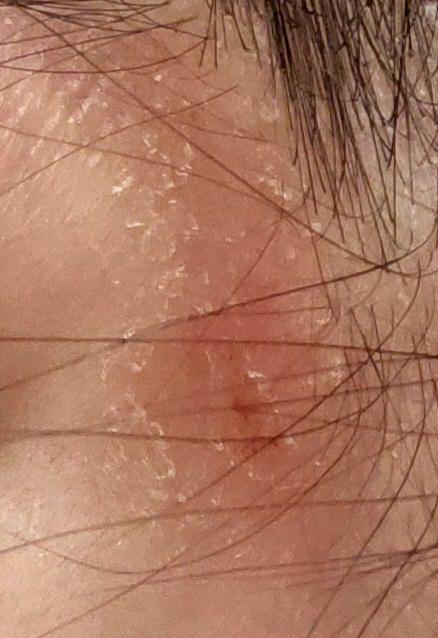 Discover more like SkincareAddicts: Dry, Flaky Skin on Hairline and Ears: Help! and Related ...