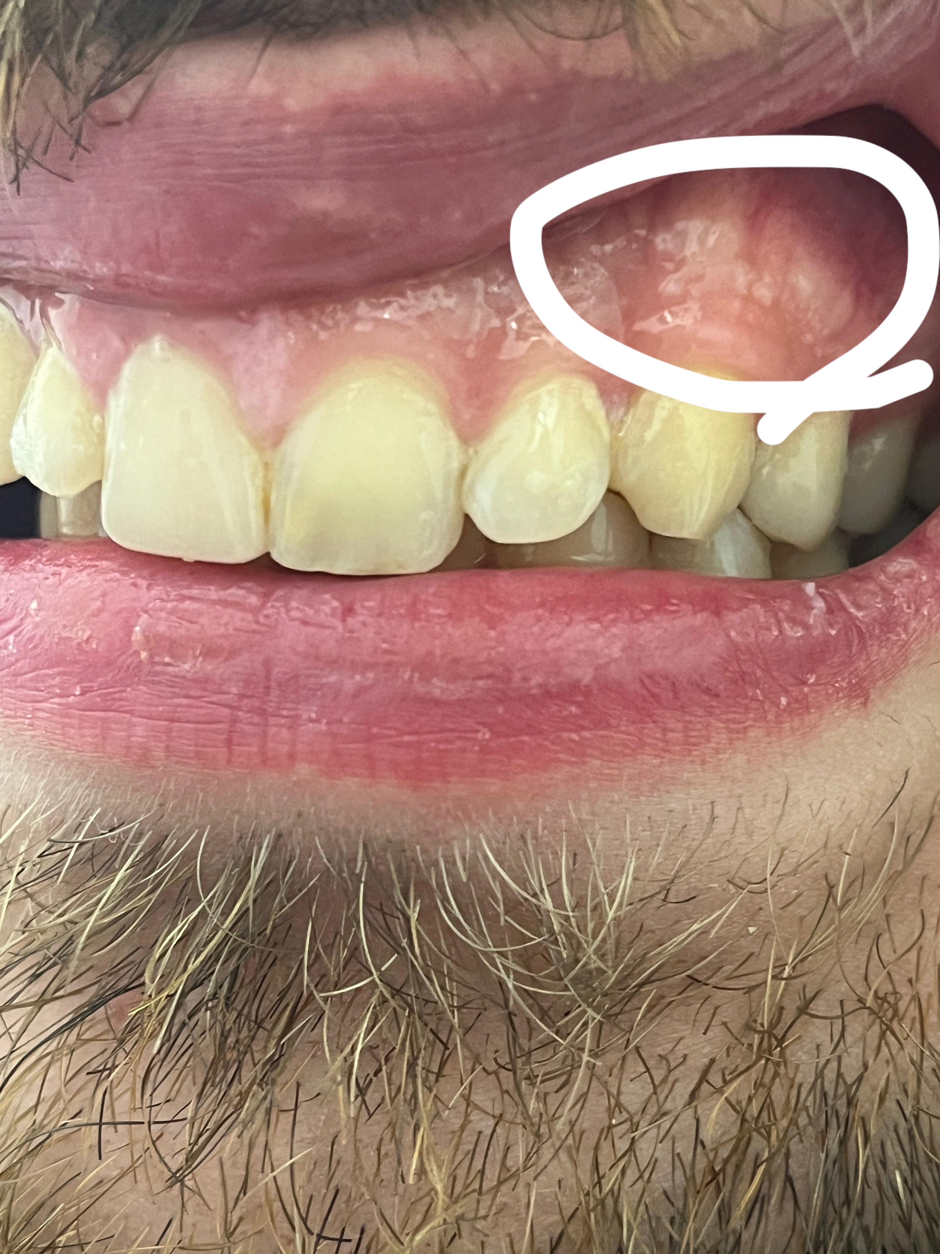 Are these bumps normal on my gums? | Scrolller