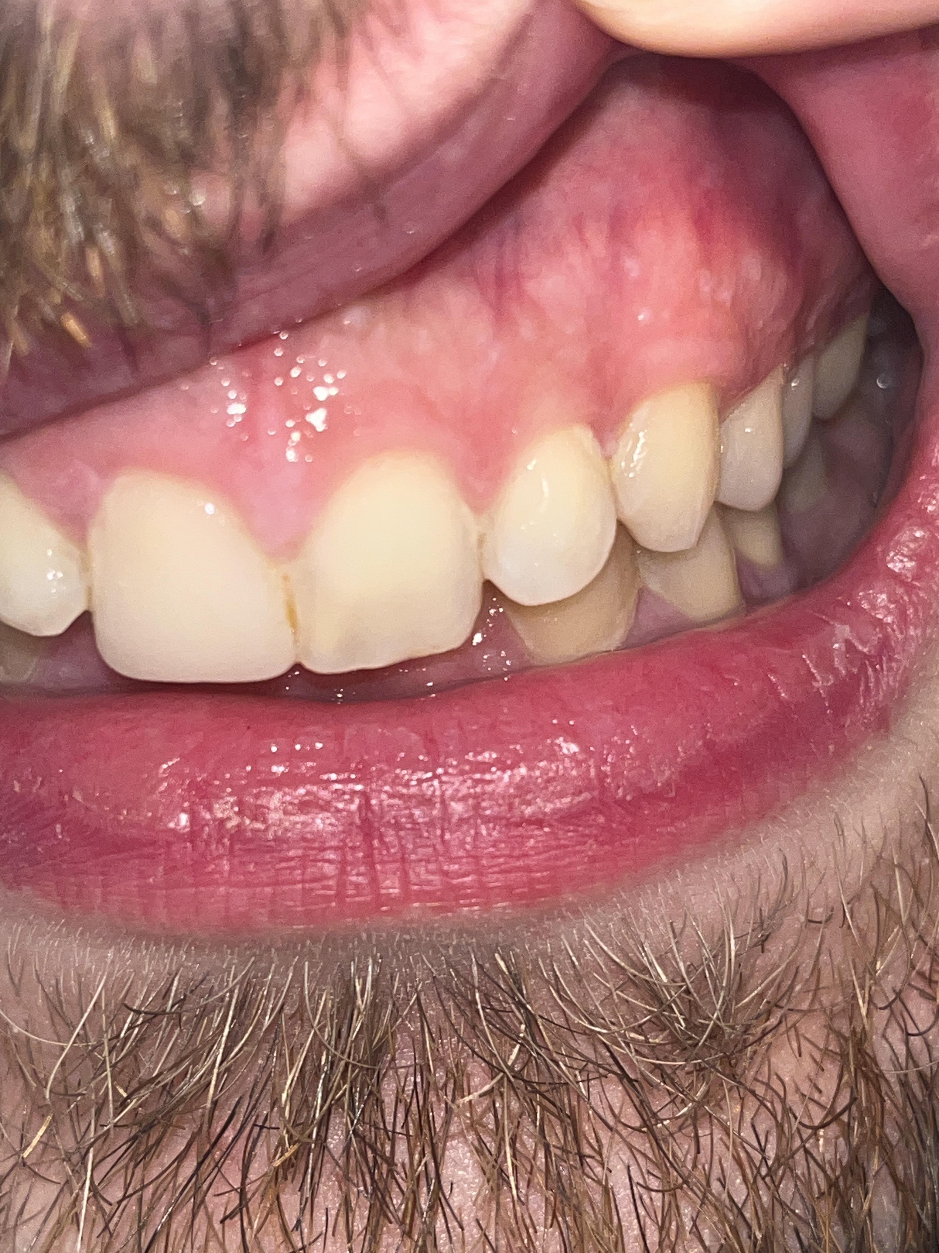 Are these bumps normal on my gums? | Scrolller