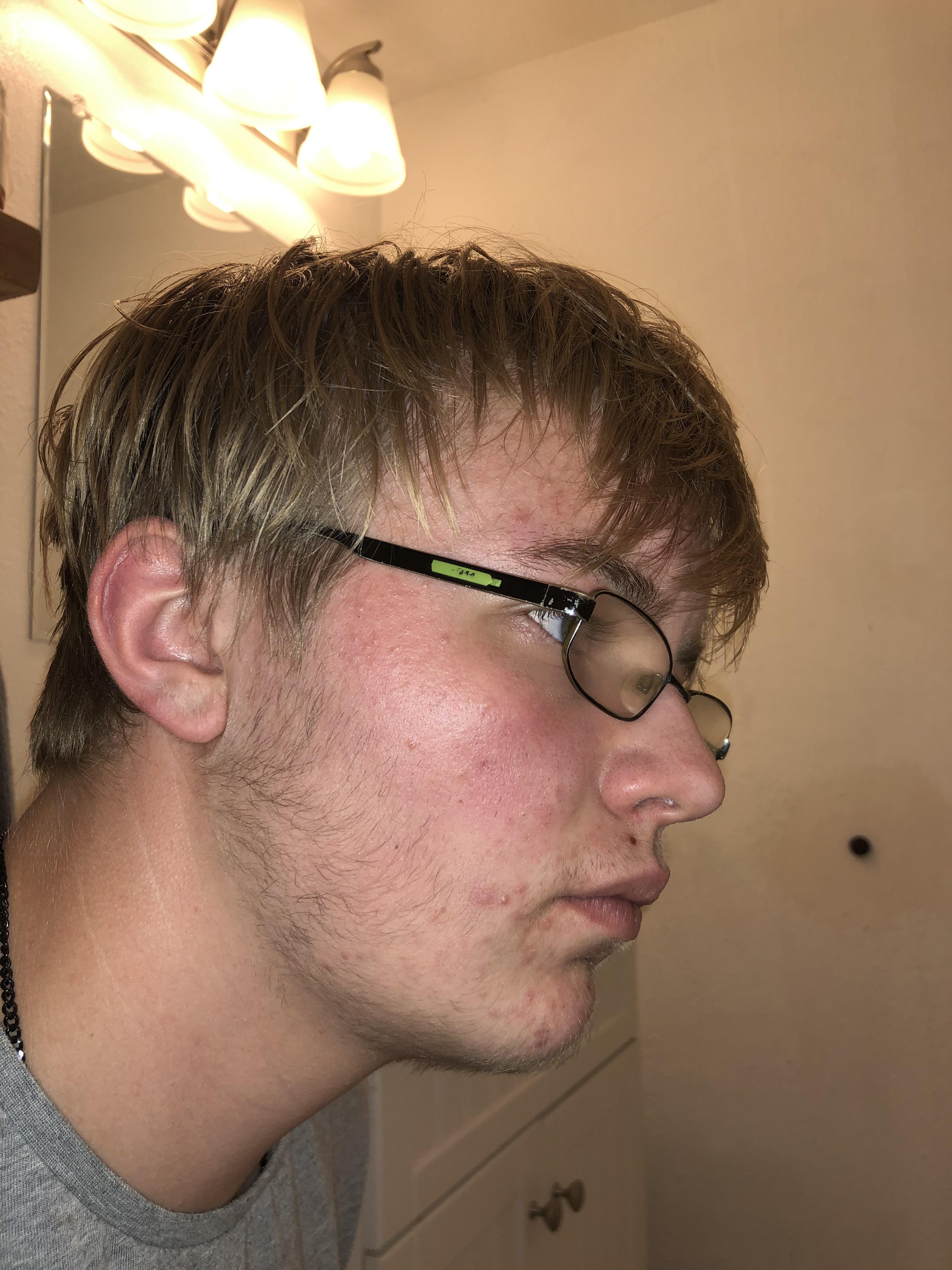 PROTIP: 2 months in with minox I barely had anything, started dermarolling a week ago and made ...