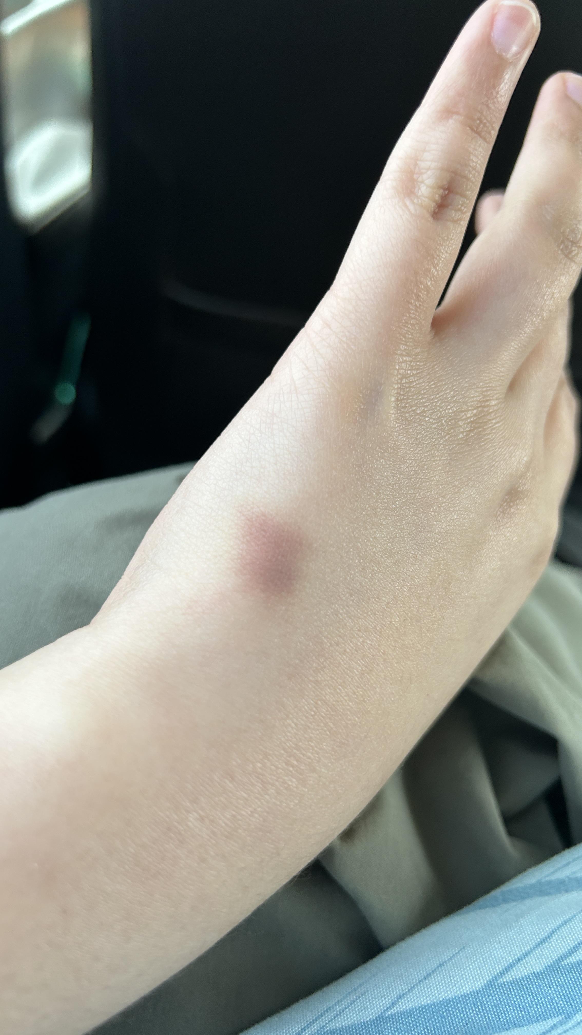 What’s this on my skin? looks like bruise but doesn’t hurt. | Scrolller