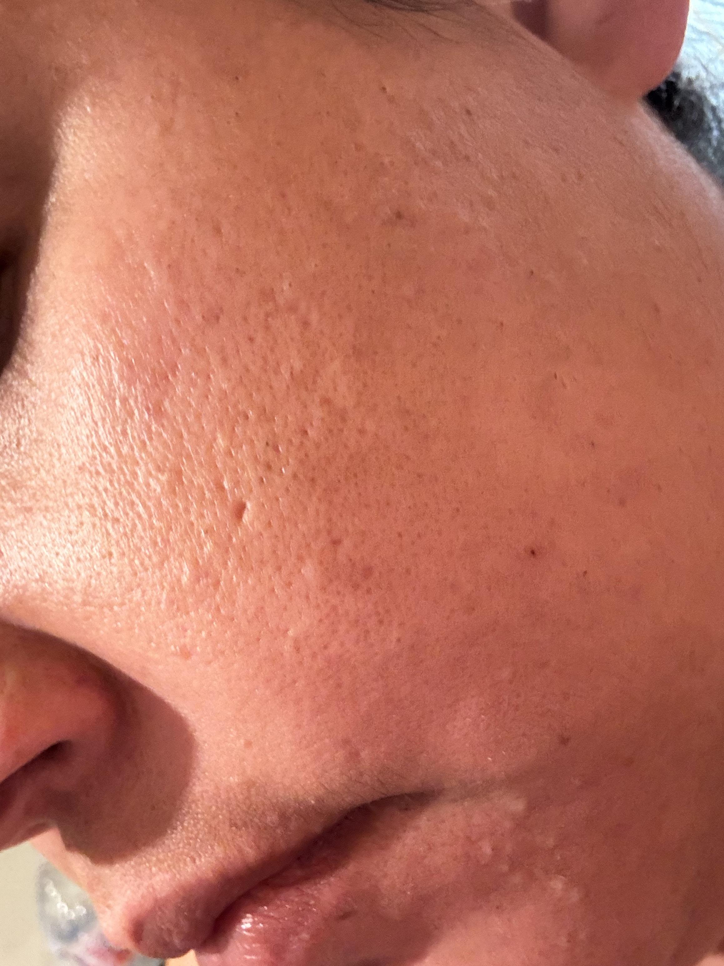 Blackheads and bumps | Scrolller