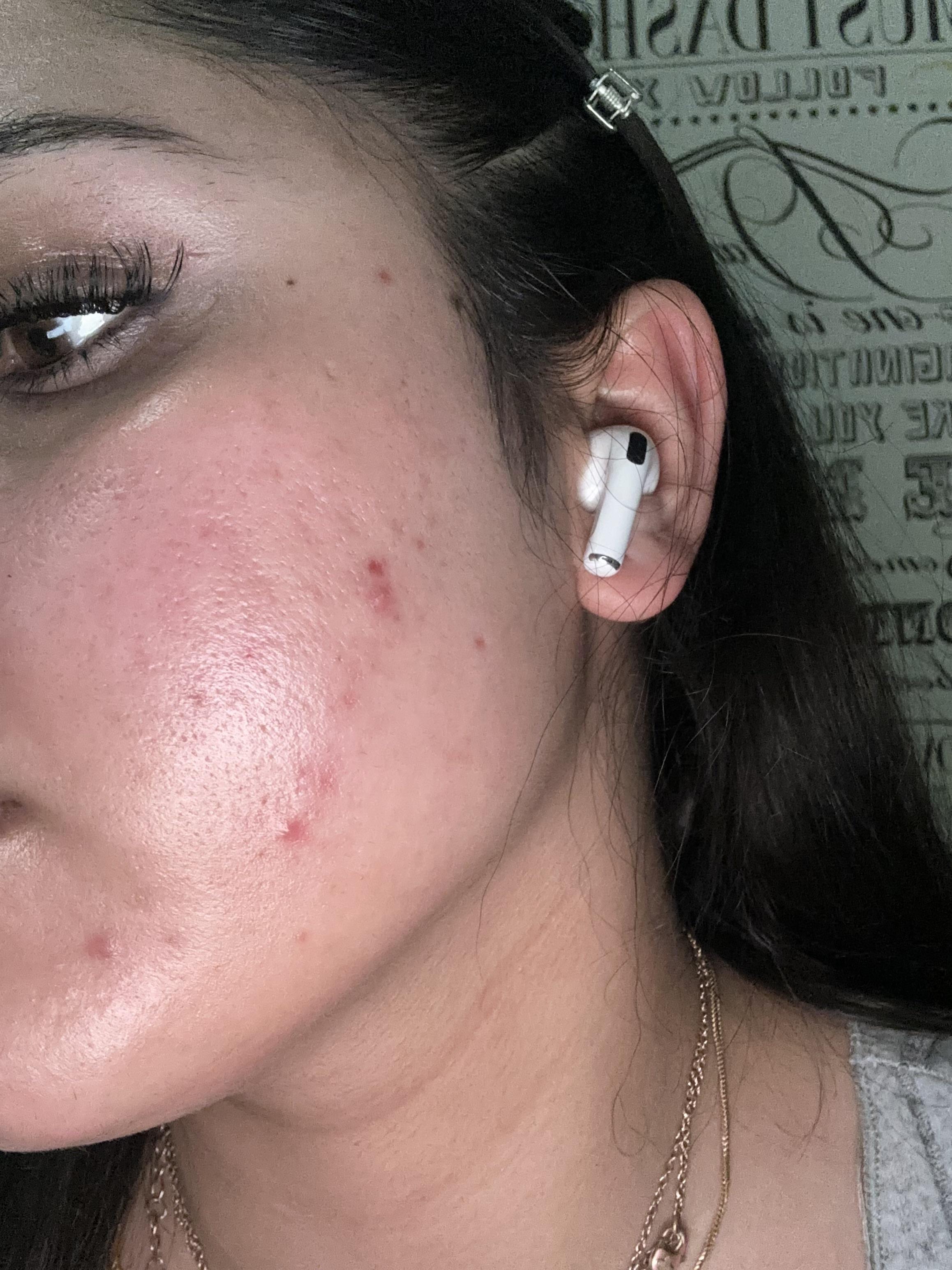 Skincare suggestions for scars | Scrolller