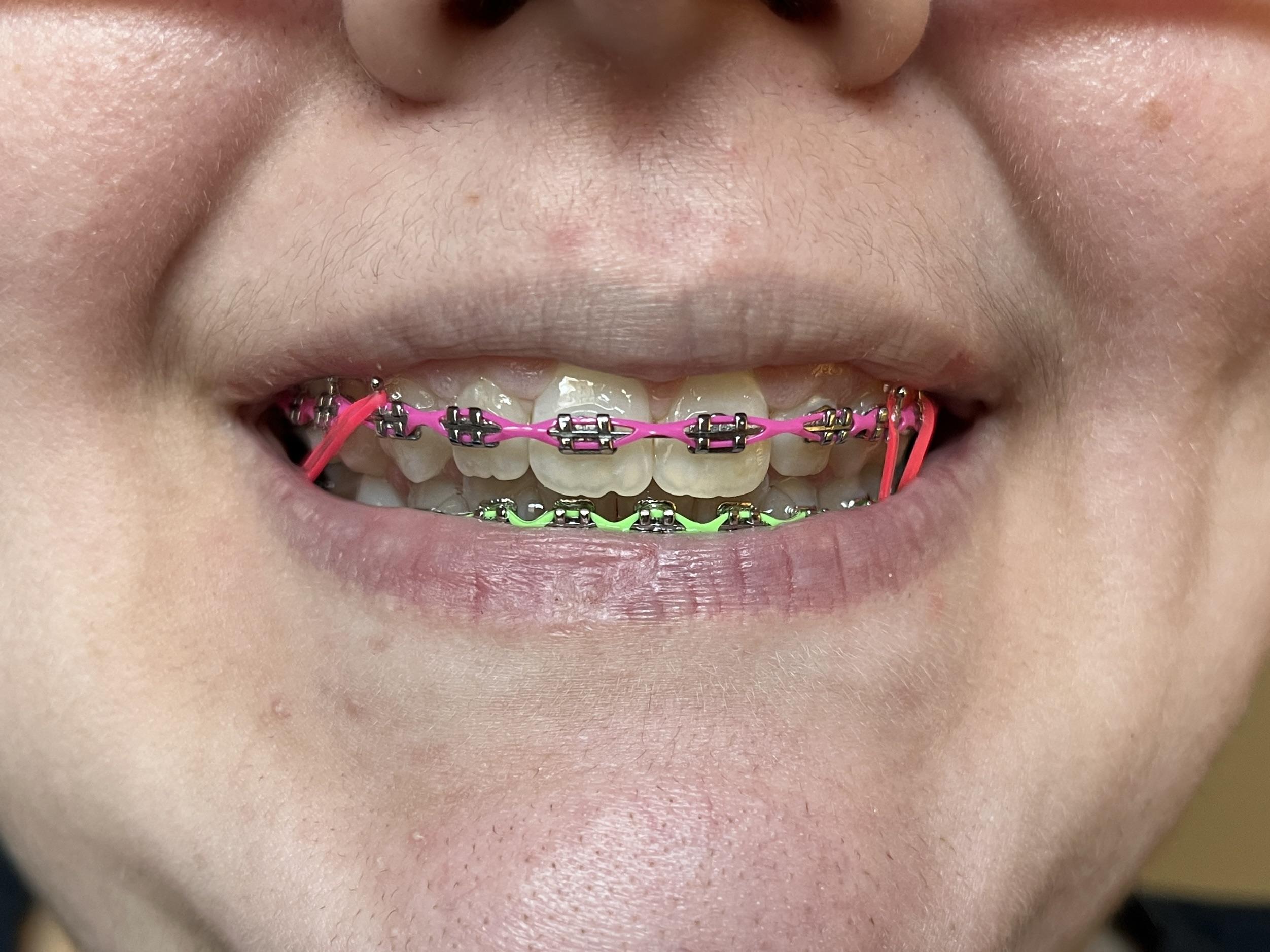 4 months in, just got power chains and elastics! My teeth feel like ...