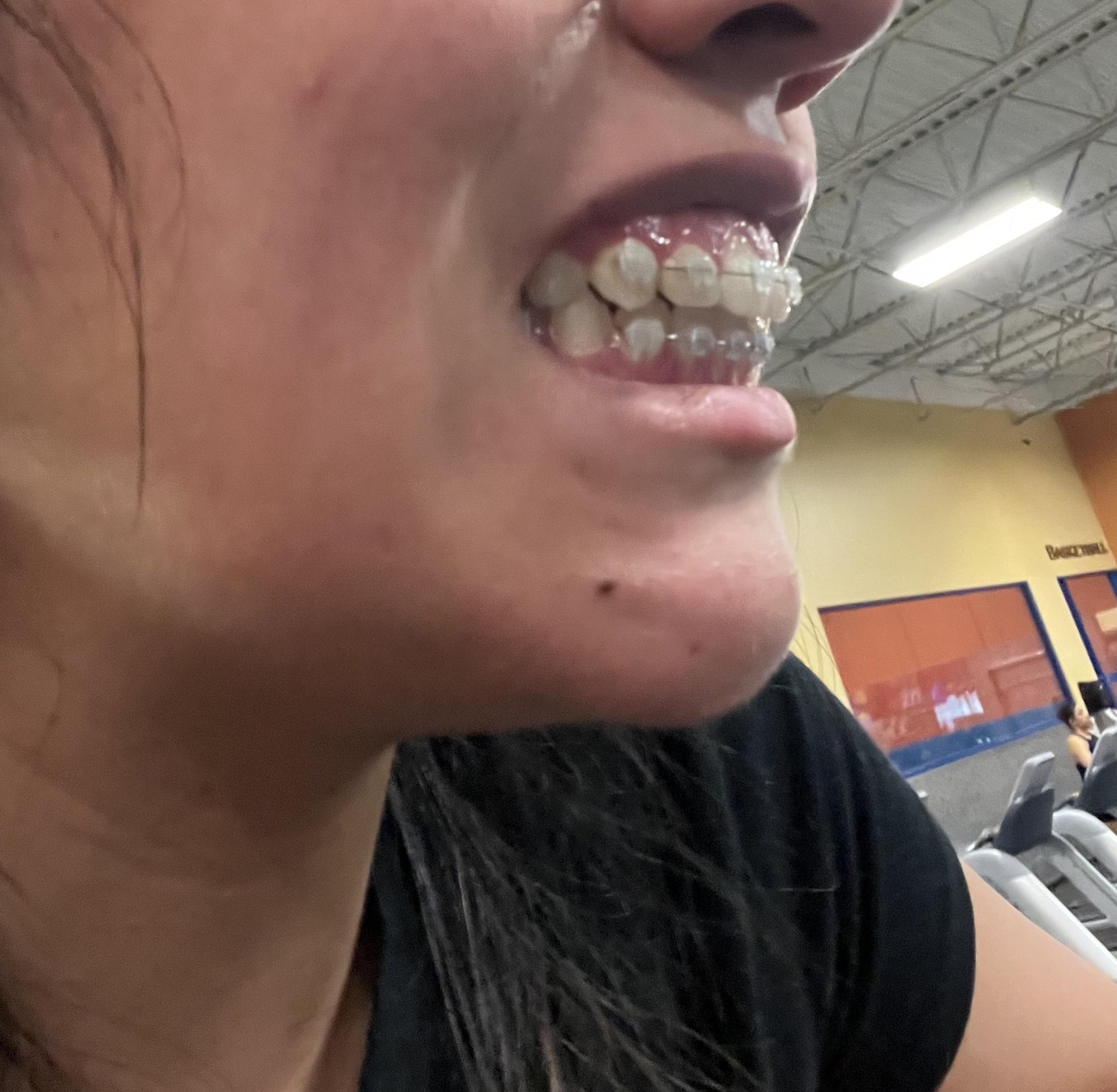 Molar extraction | Scrolller