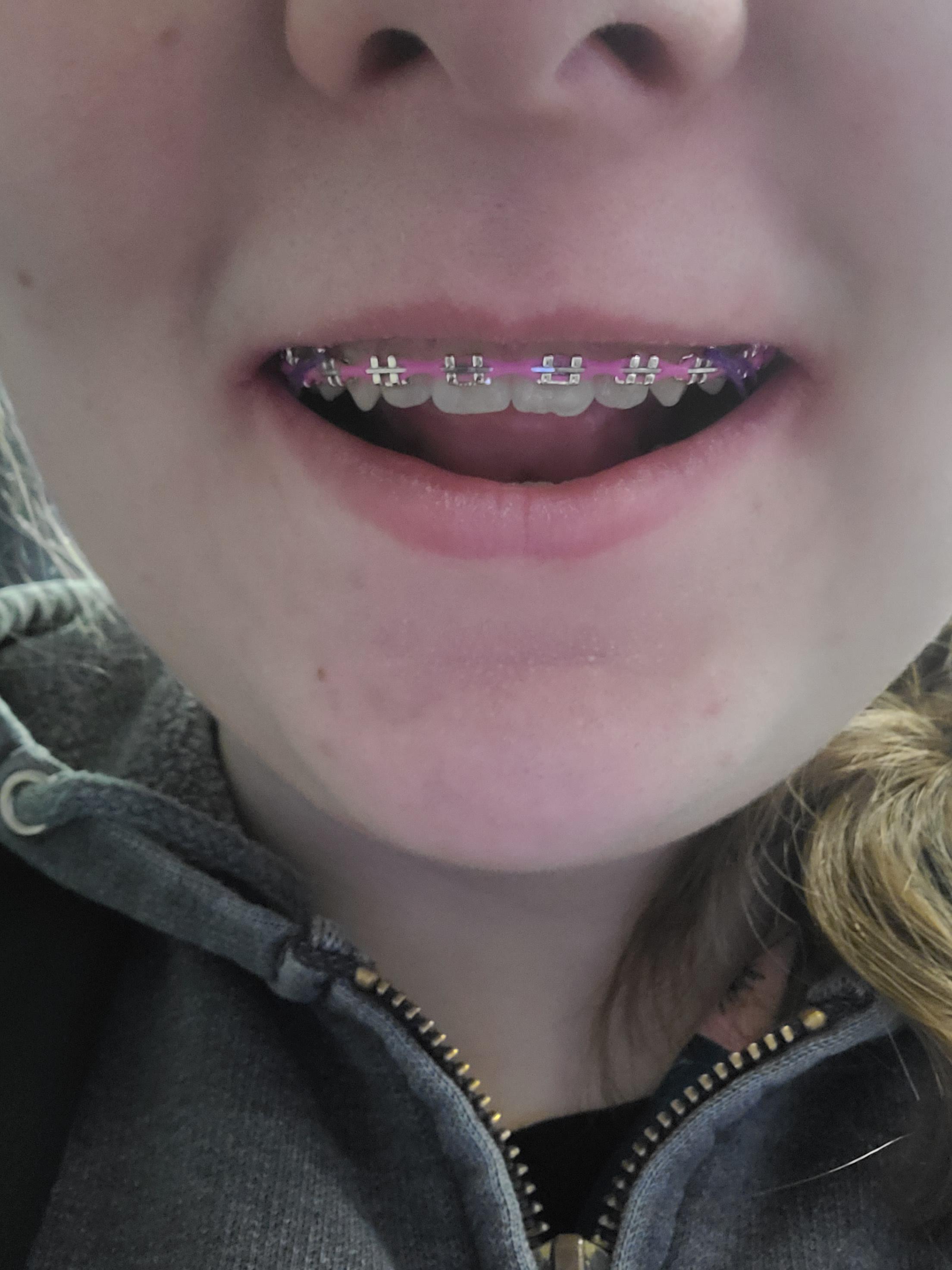 My front teeth are touching | Scrolller