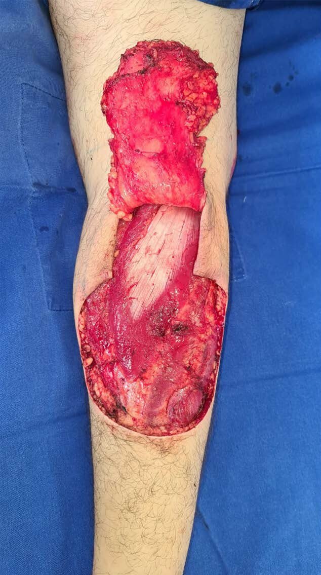 Bilateral knee soft-tissue reconstruction after high-voltage electrical ...