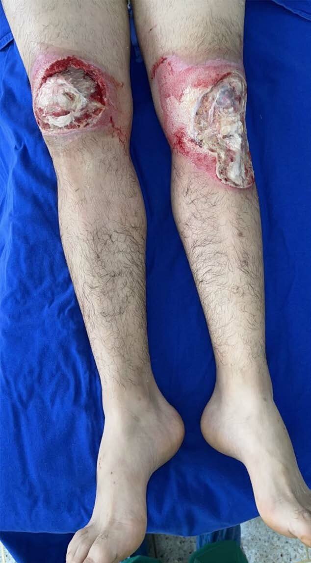 Bilateral knee soft-tissue reconstruction after high-voltage electrical ...