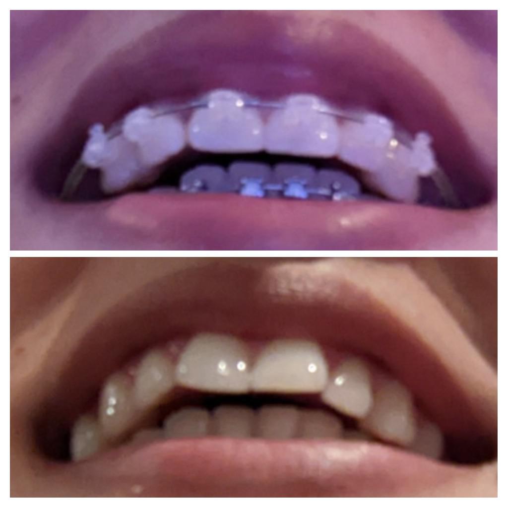 4 months progress with premolar extractions. Trying to correct 7mm overjet | Scrolller