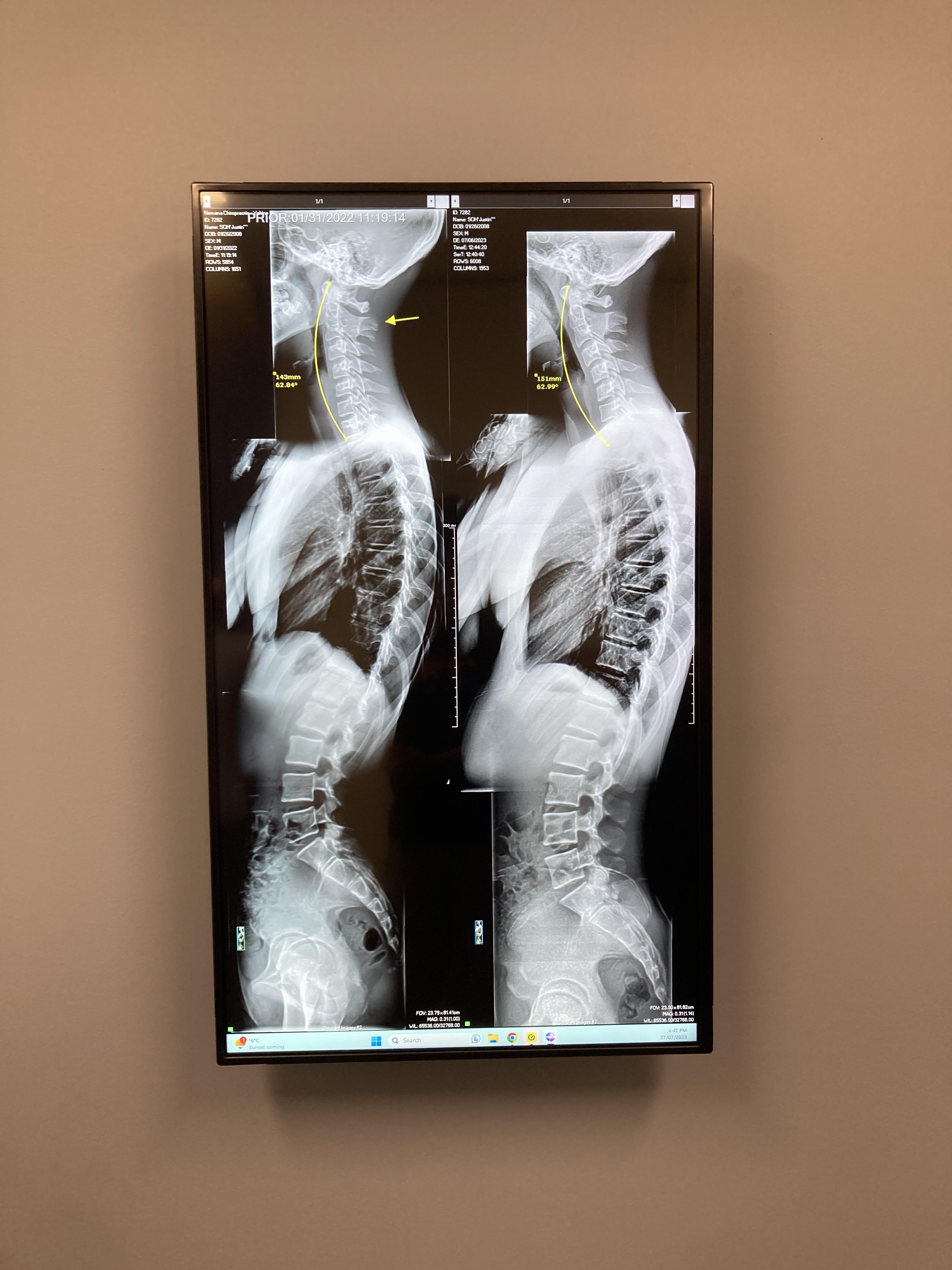 Spine Xray; what can you tell | Scrolller