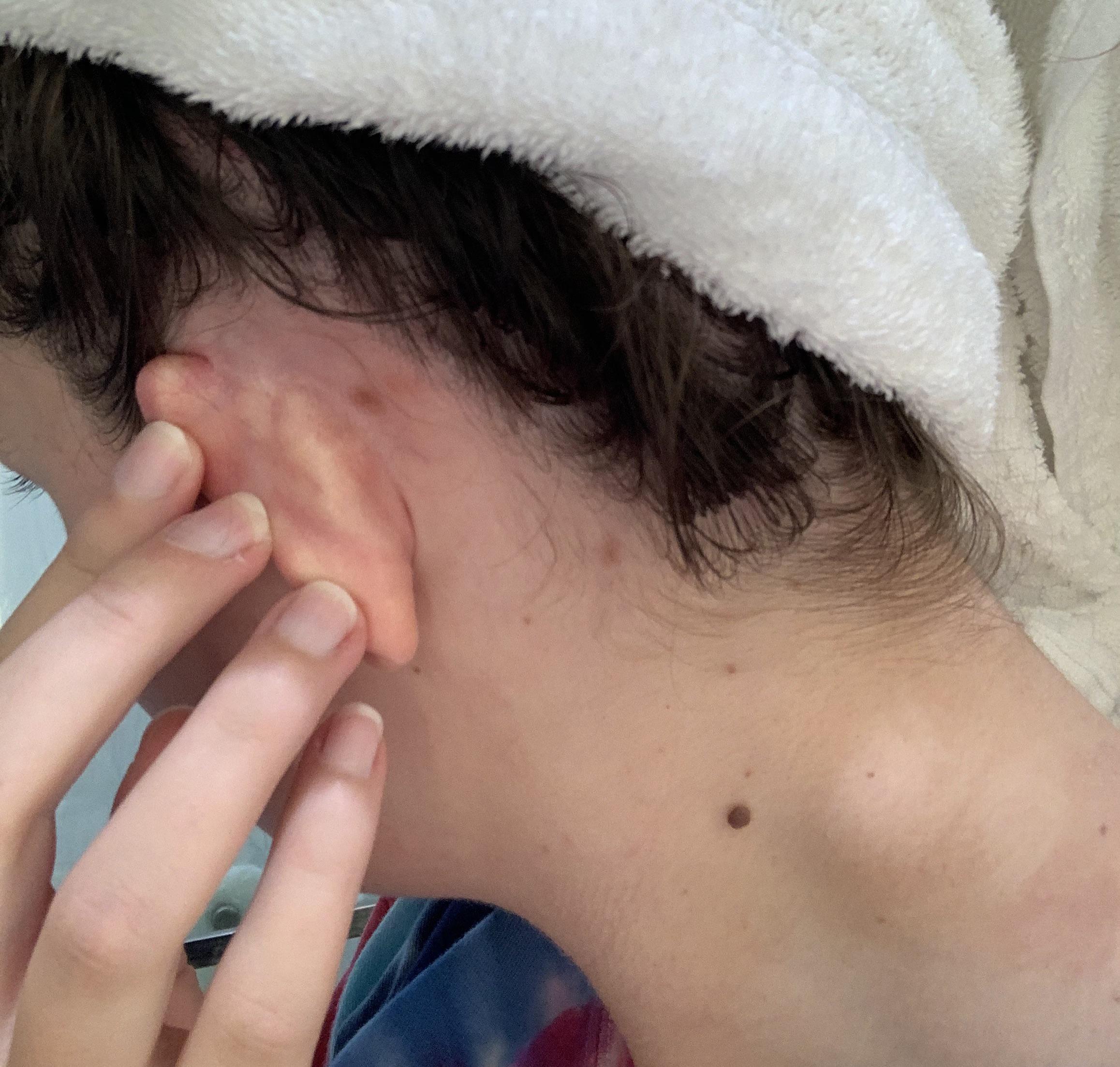 Swollen Lymph Node appeared couple days after burning scalp feeling. 3 Redness spots on scalp ...