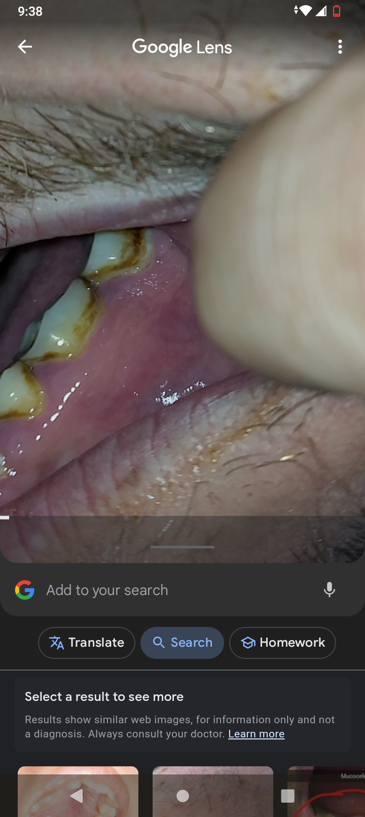 Help?? What is going on with my gums?? | Scrolller
