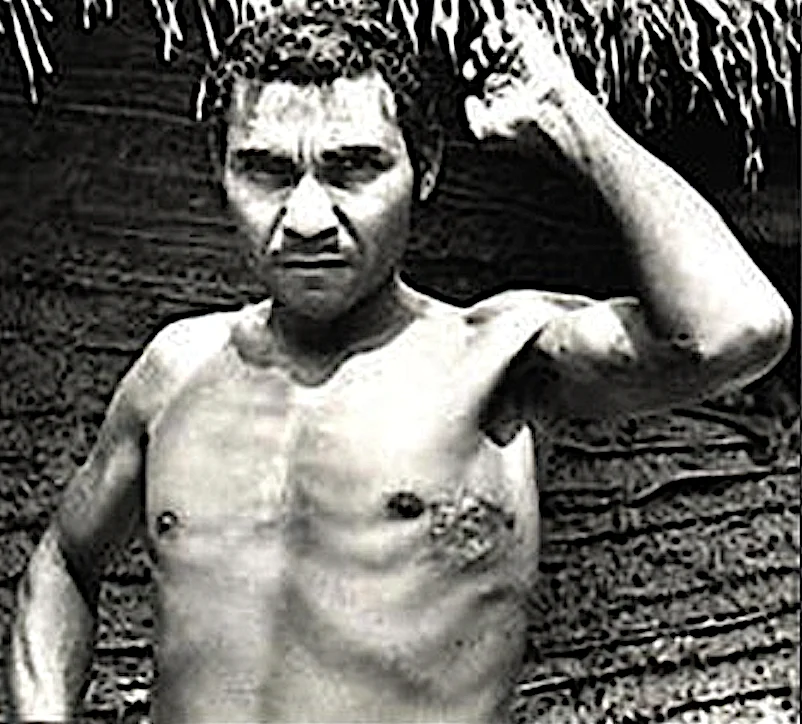 This Photographic Evidence Shows Firmino Souza S Radiation Burn After