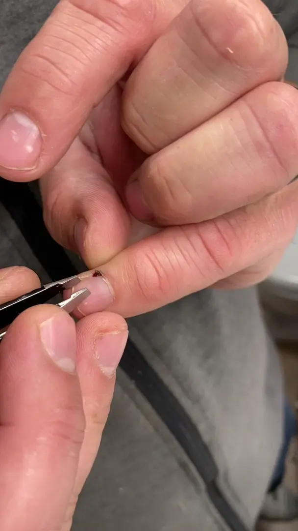 Thorn stuck in pinky finger removal | Scrolller