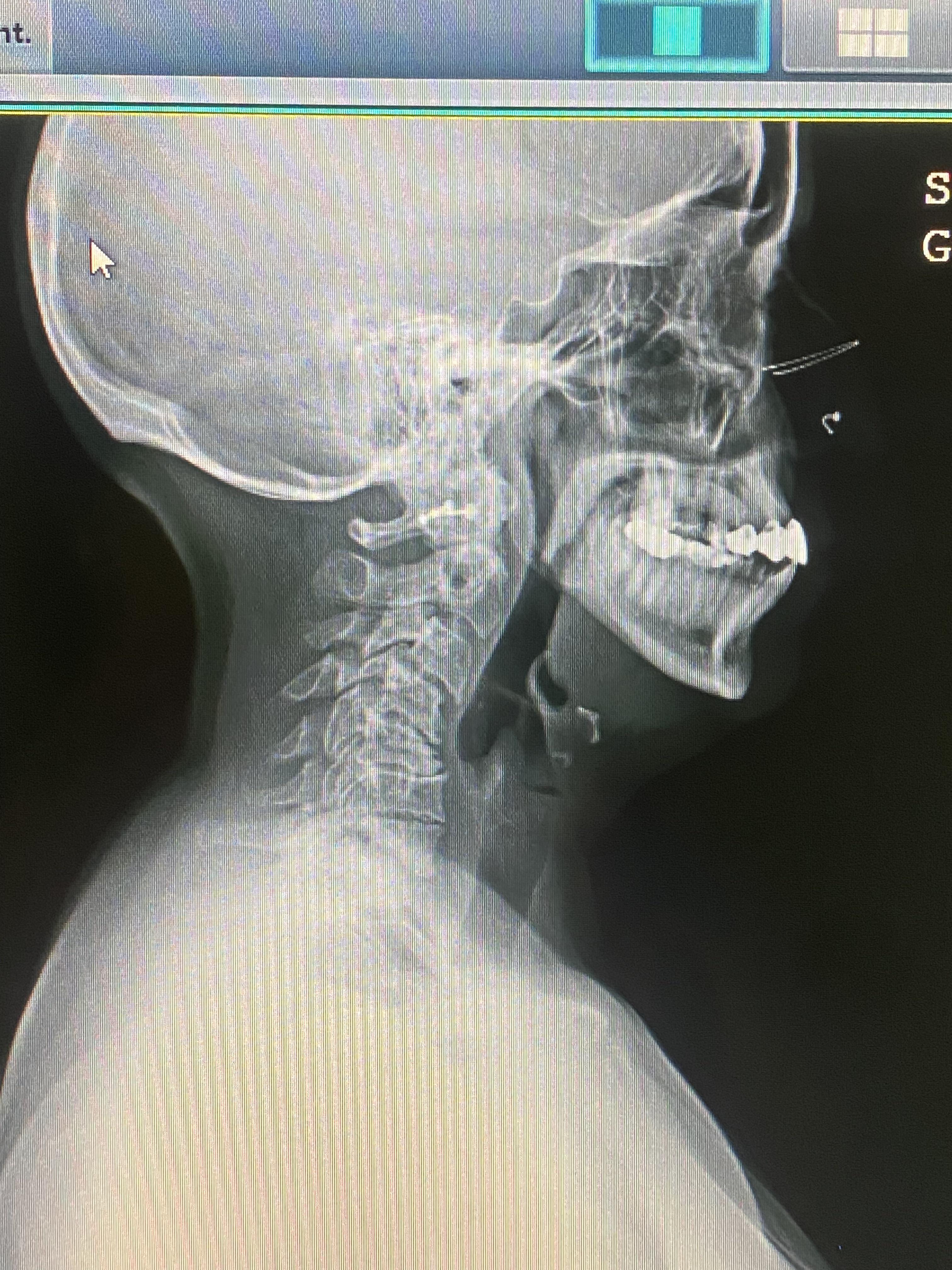Guess patient age by condition of c-spine? | Scrolller