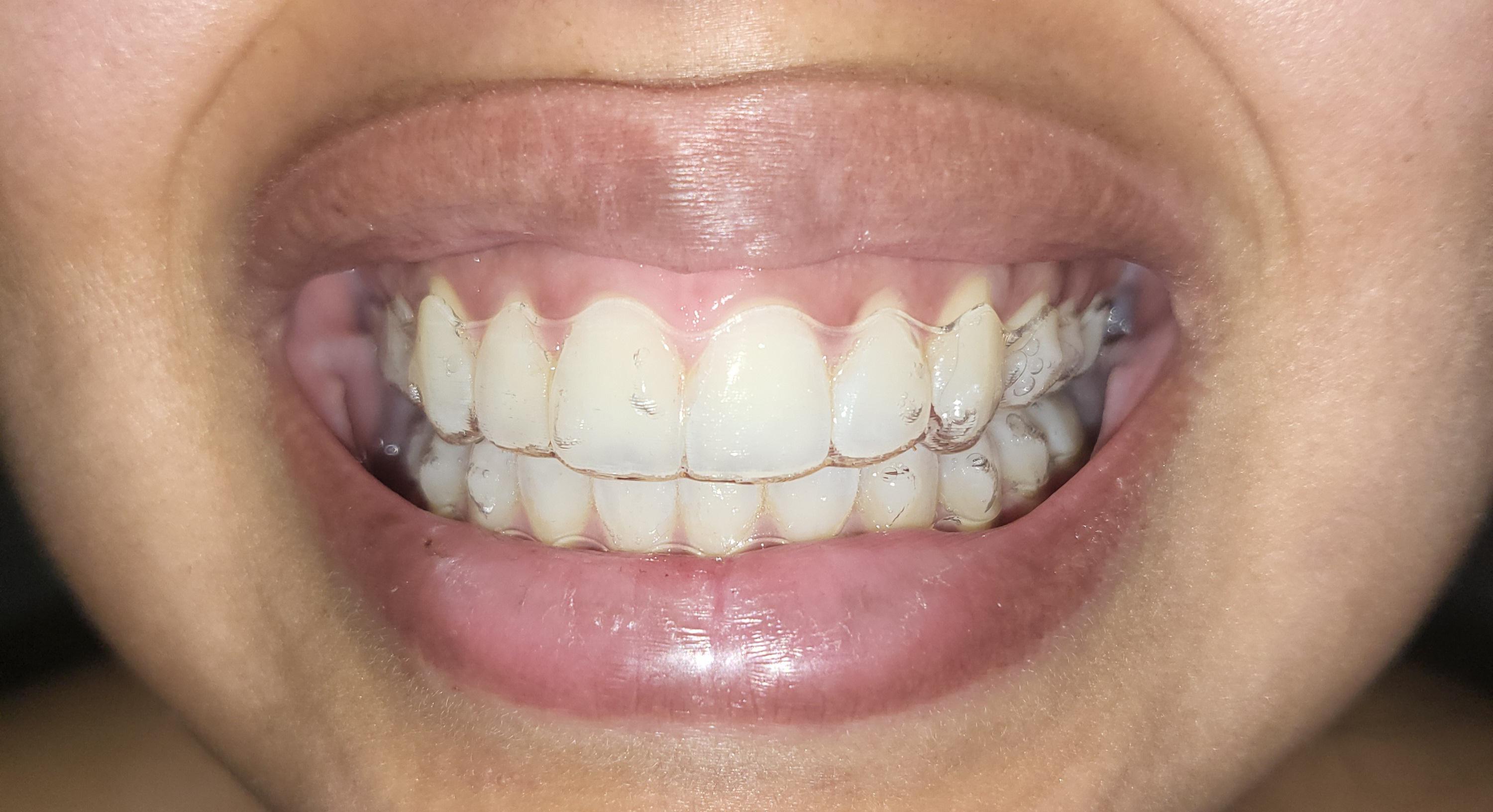 Discover more like Invisalign: Not tracking on one tooth and Related Content | Scrolller