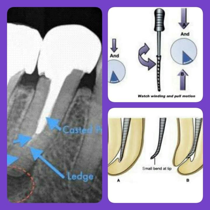 Understanding Ledge Formation in Root Canal Treatment: Causes, Prevention, and Solutions | Scrolller
