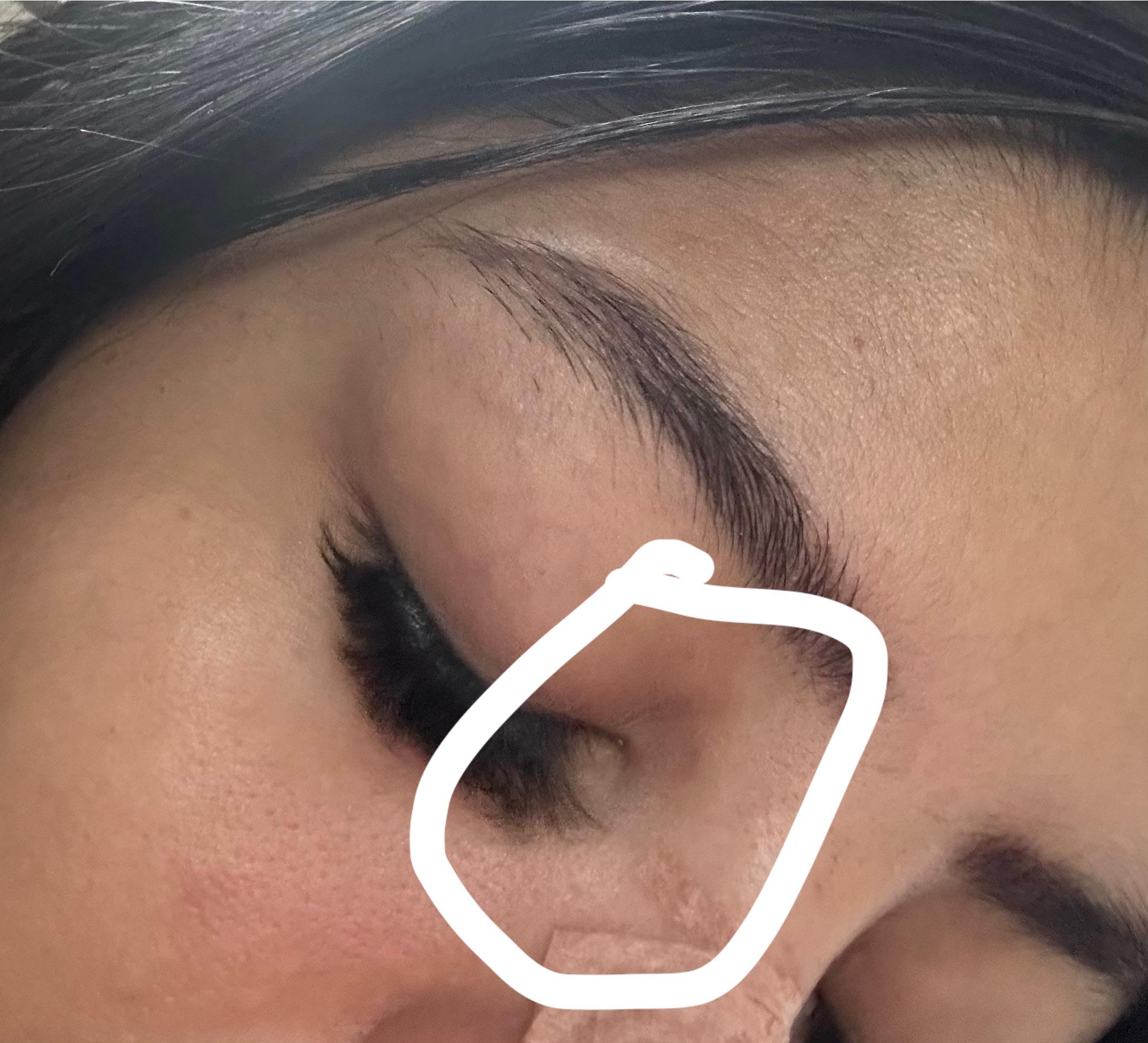 Nose filler HELP | Scrolller