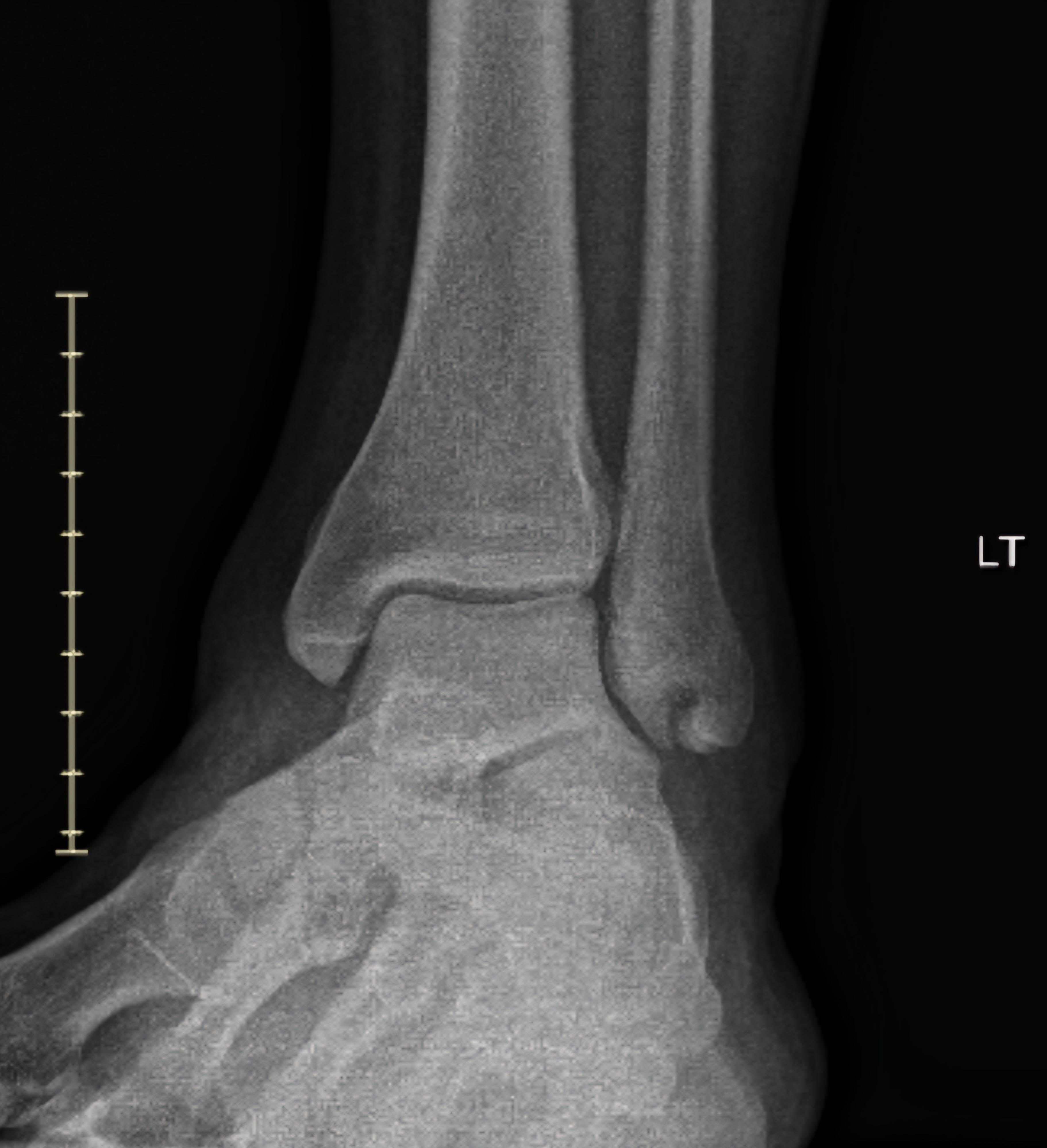 Weber A Ankle Fracture | Scrolller
