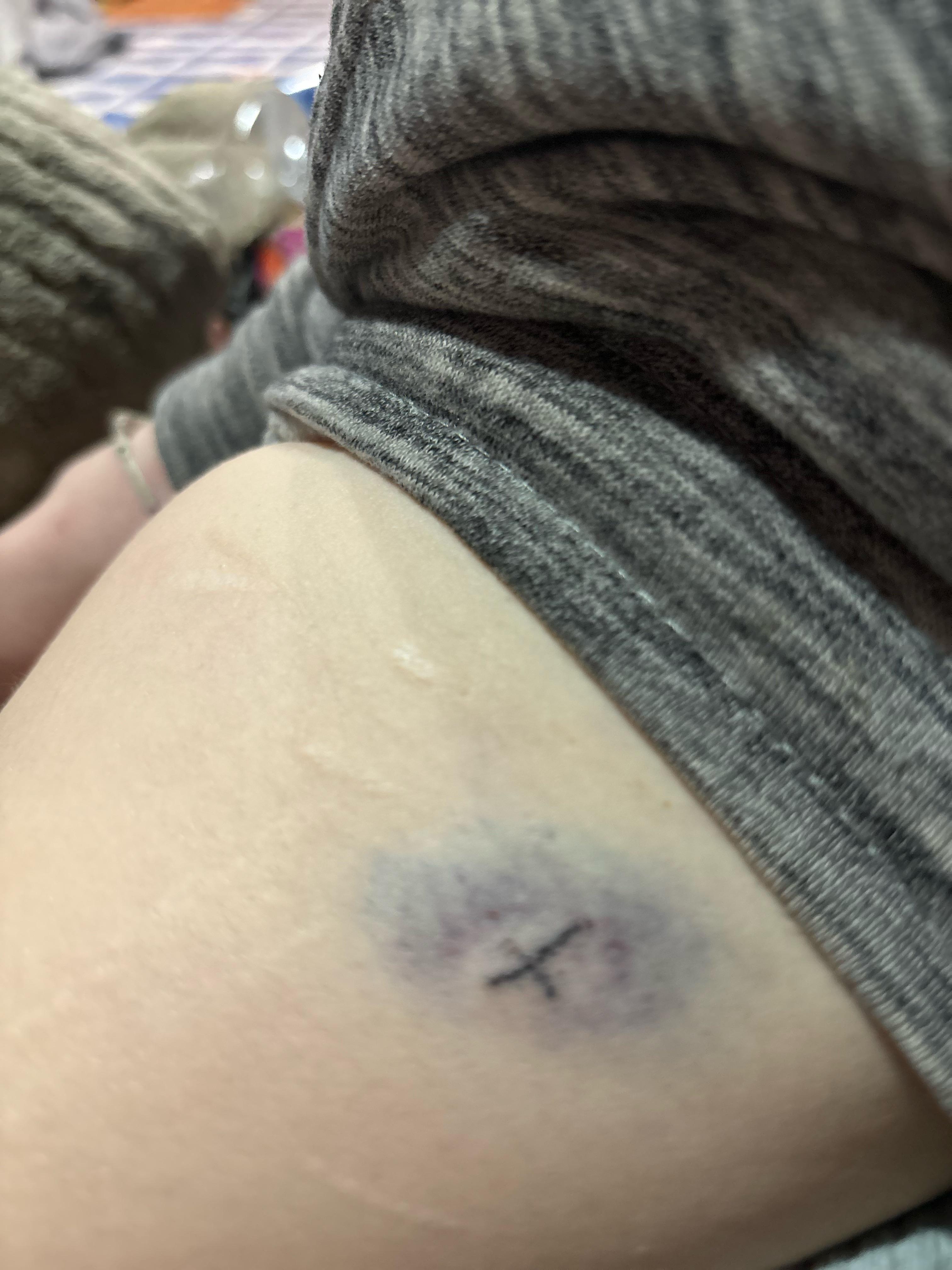 Why did this bruise? | Scrolller