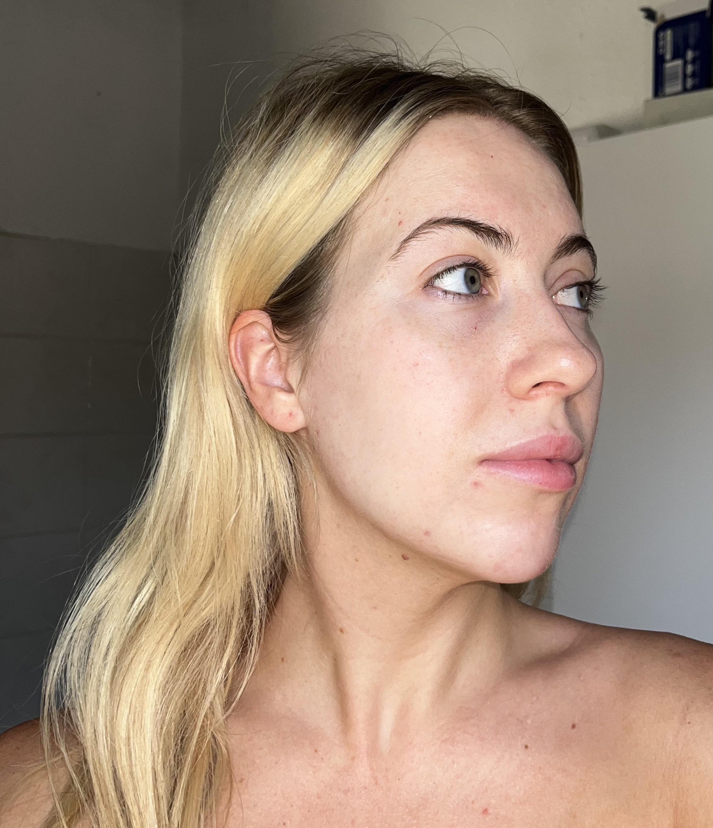 2 Months vs. 4 Months on Tretinoin | Scrolller