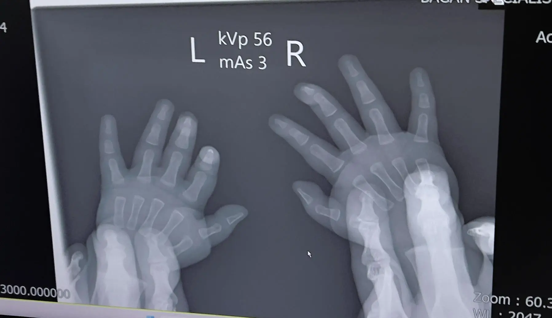 X-ray of my 9 months hands. There are no bones connecting to his fingers | Scrolller